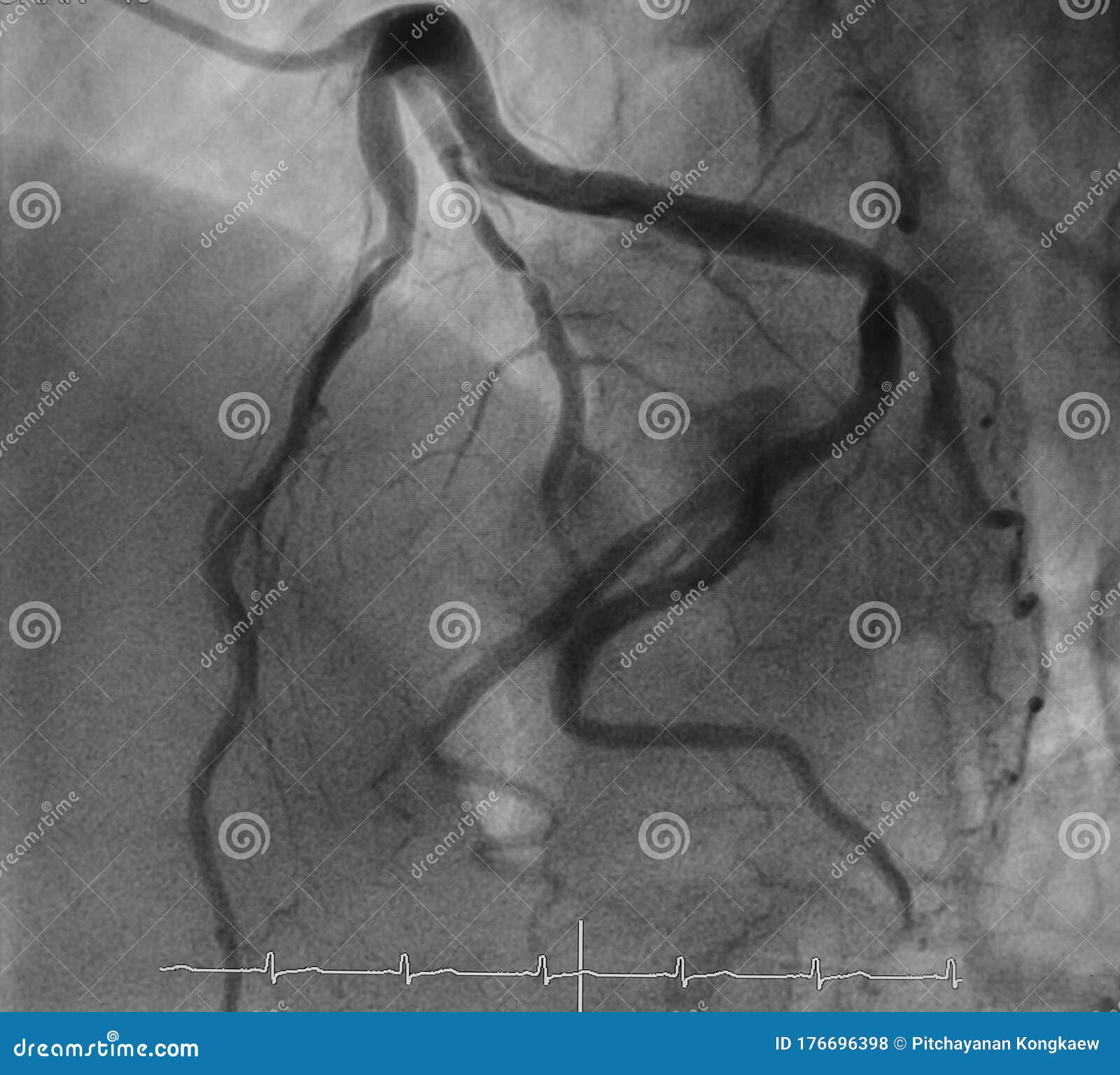 Coronary Angiography. X-ray Image. Stock Illustration - Illustration of ...