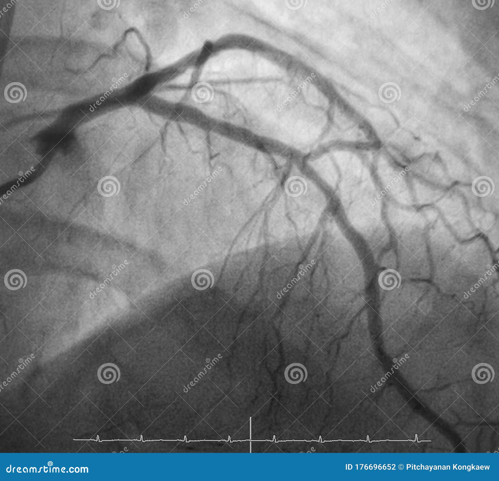 Coronary Angiography. X-ray Image. Stock Illustration - Illustration of ...