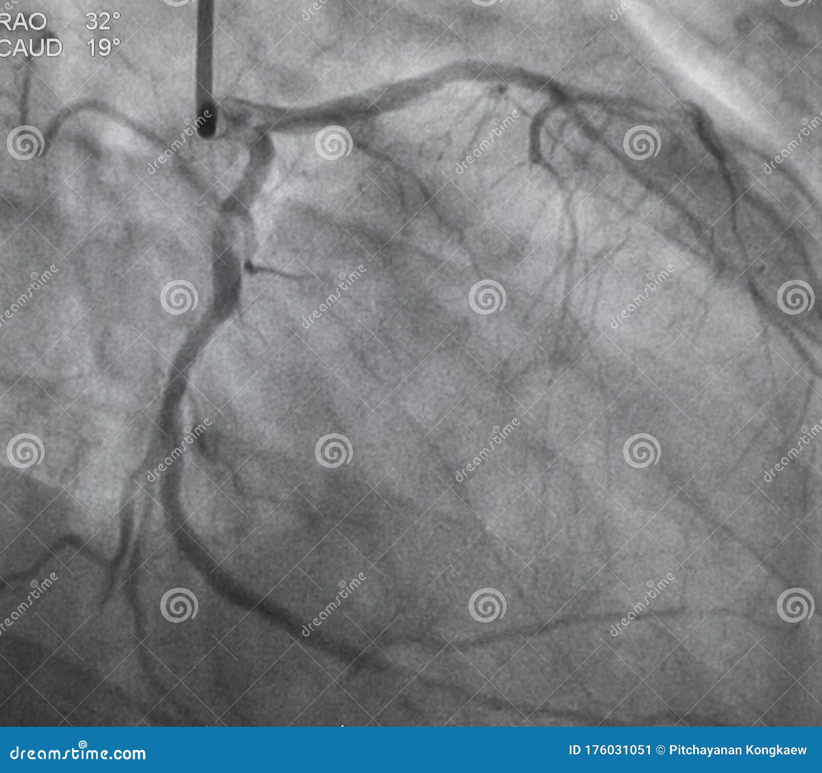 Coronary Angiography. X-ray Image. Stock Image - Image of branch ...