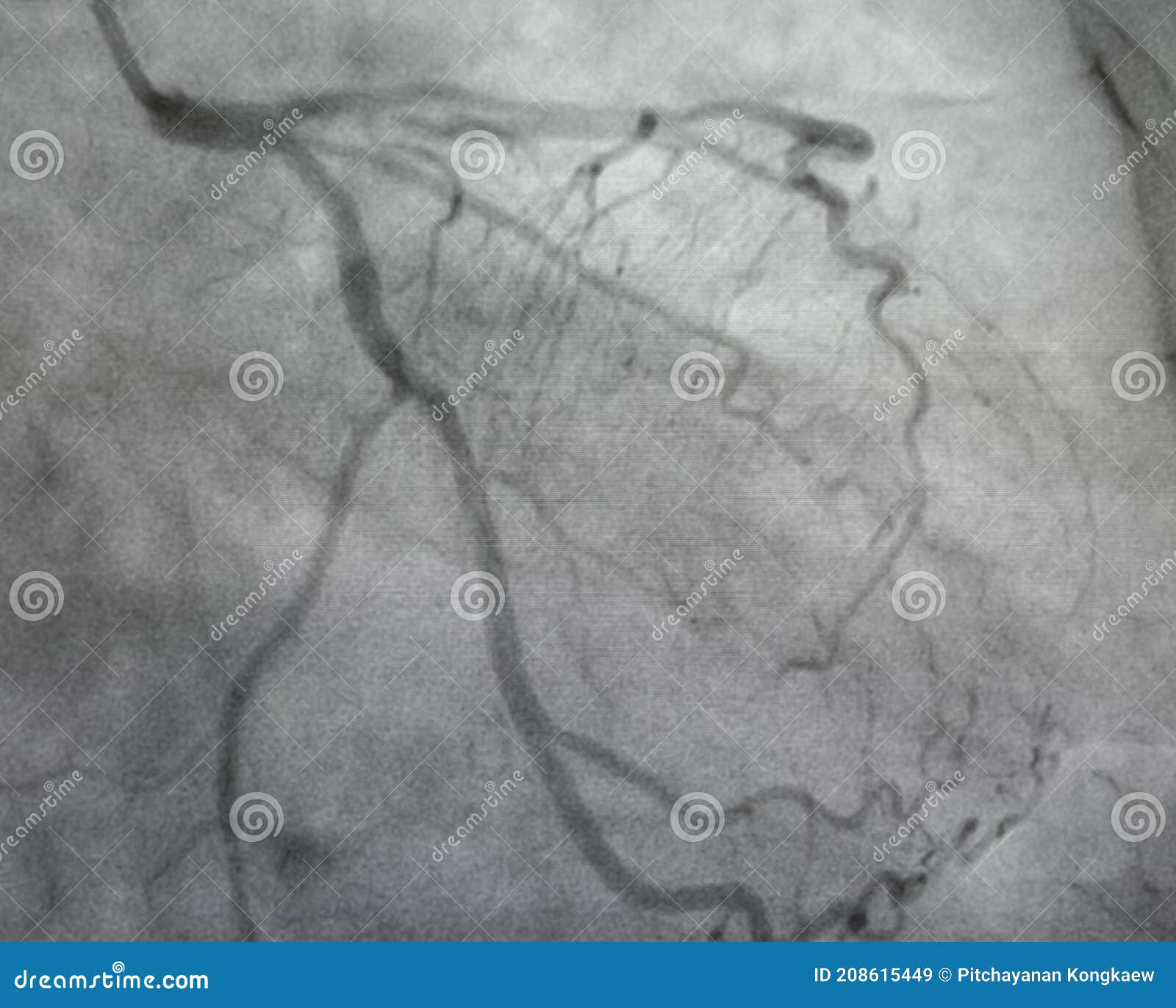 Coronary Angiography. X-ray Image. Stock Image - Image of hearts ...