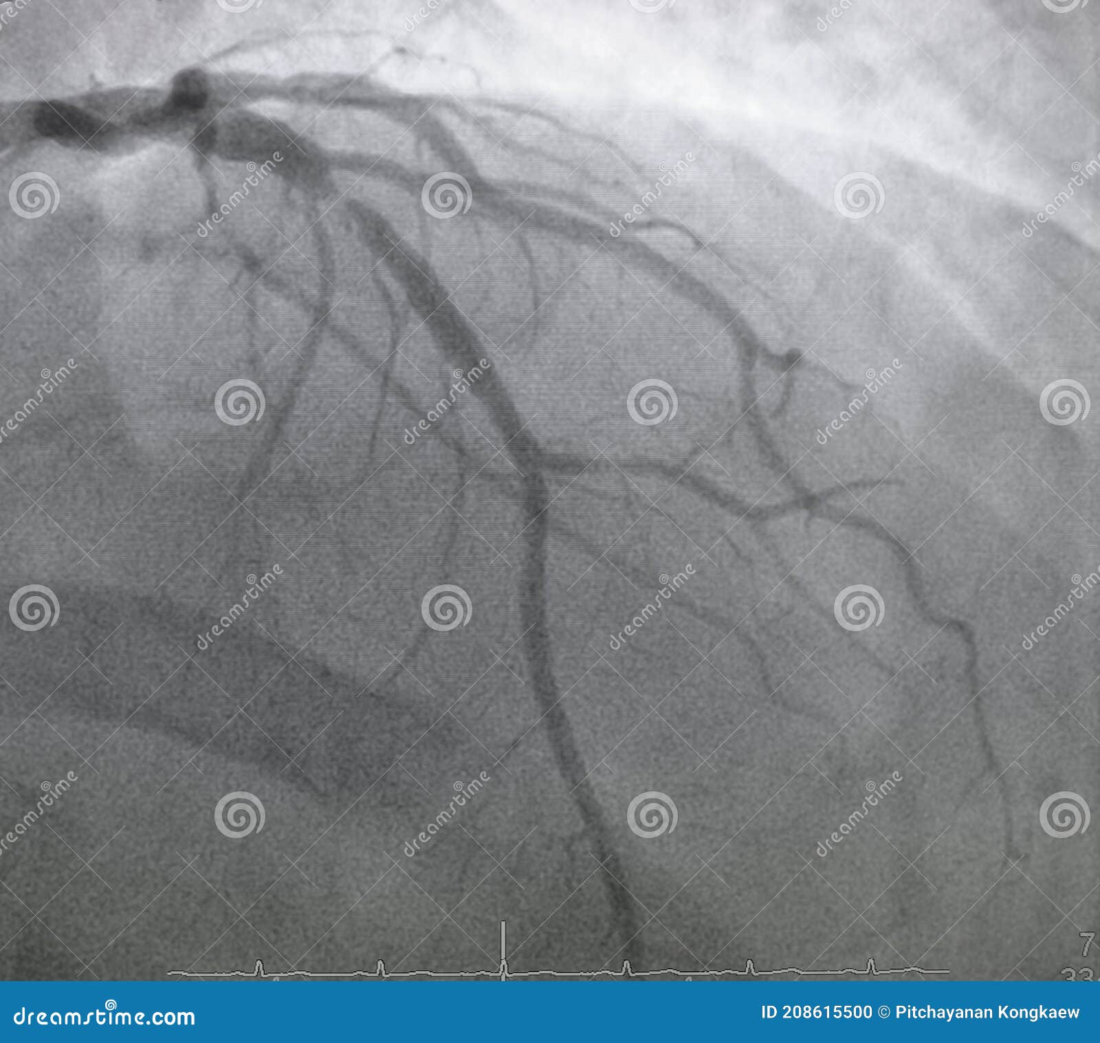 Coronary Angiography. X-ray Image. Stock Photo - Image of creative ...