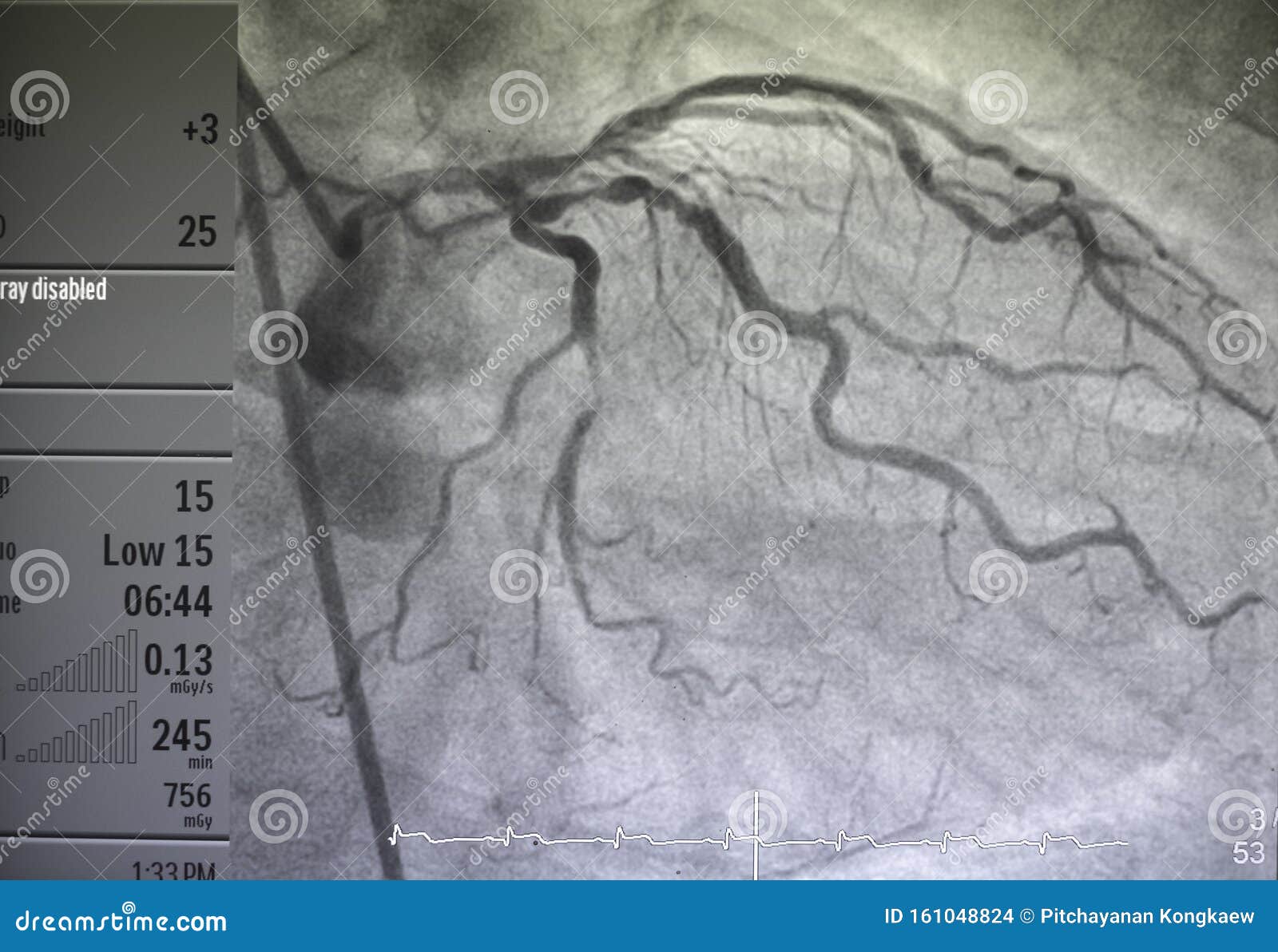 Coronary Angiography. X-ray Image. Stock Photo - Image of ...