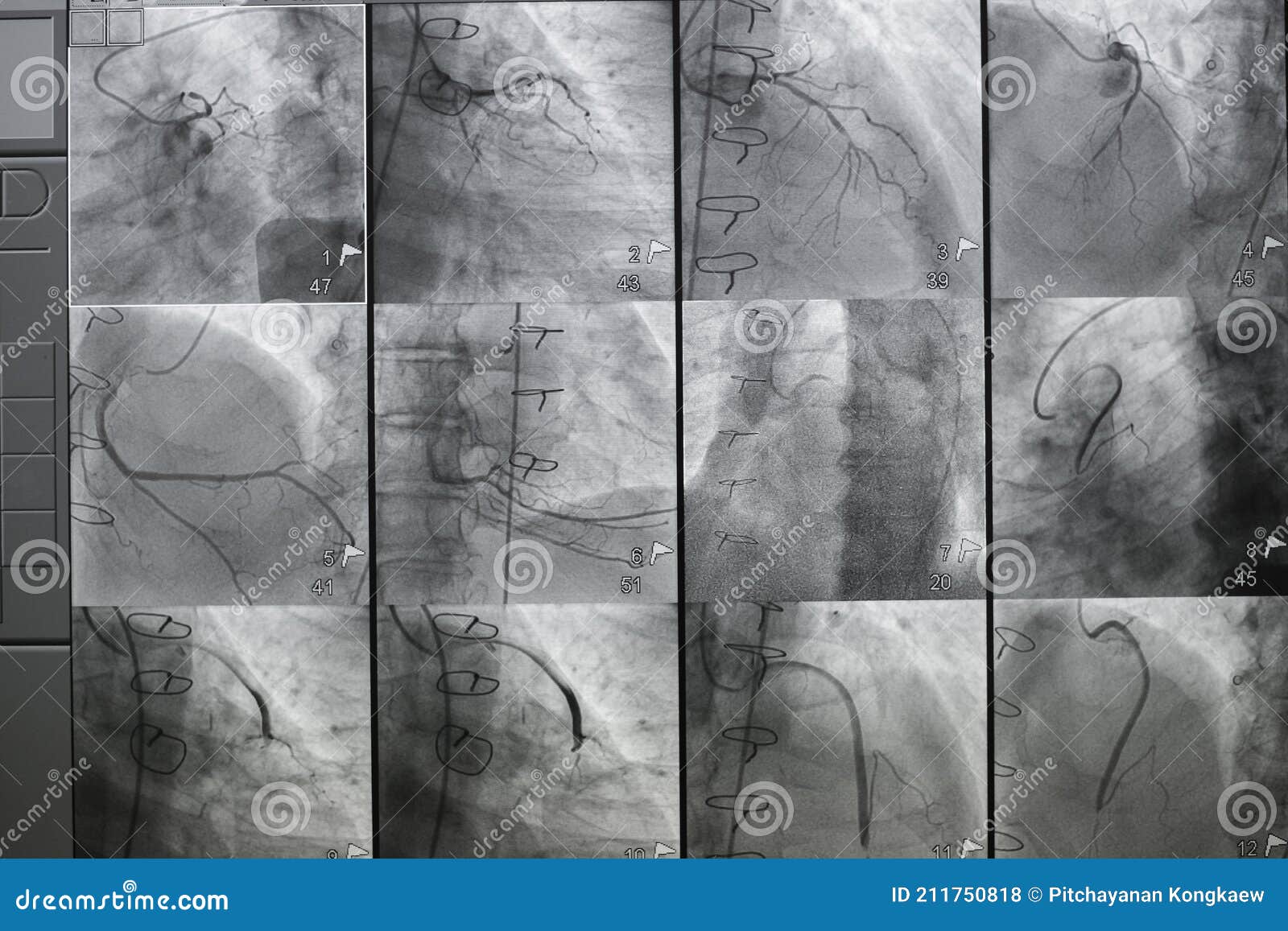 Coronary Angiography. X-ray Image. Stock Photo - Image of equipment ...