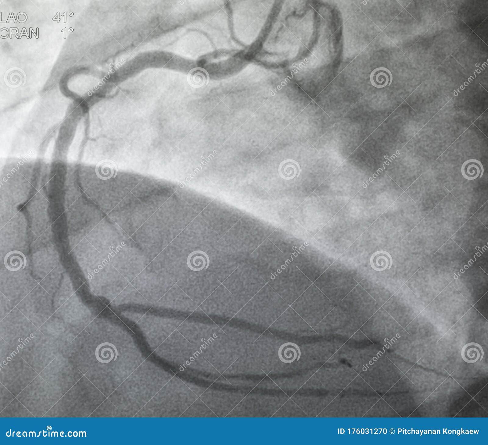 Coronary Angiography. X-ray Image. Stock Photo - Image of hospital ...