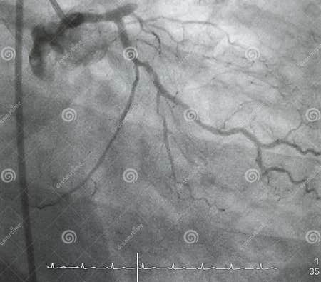 Coronary Angiography. X-ray Image. Stock Image - Image of diagonal ...