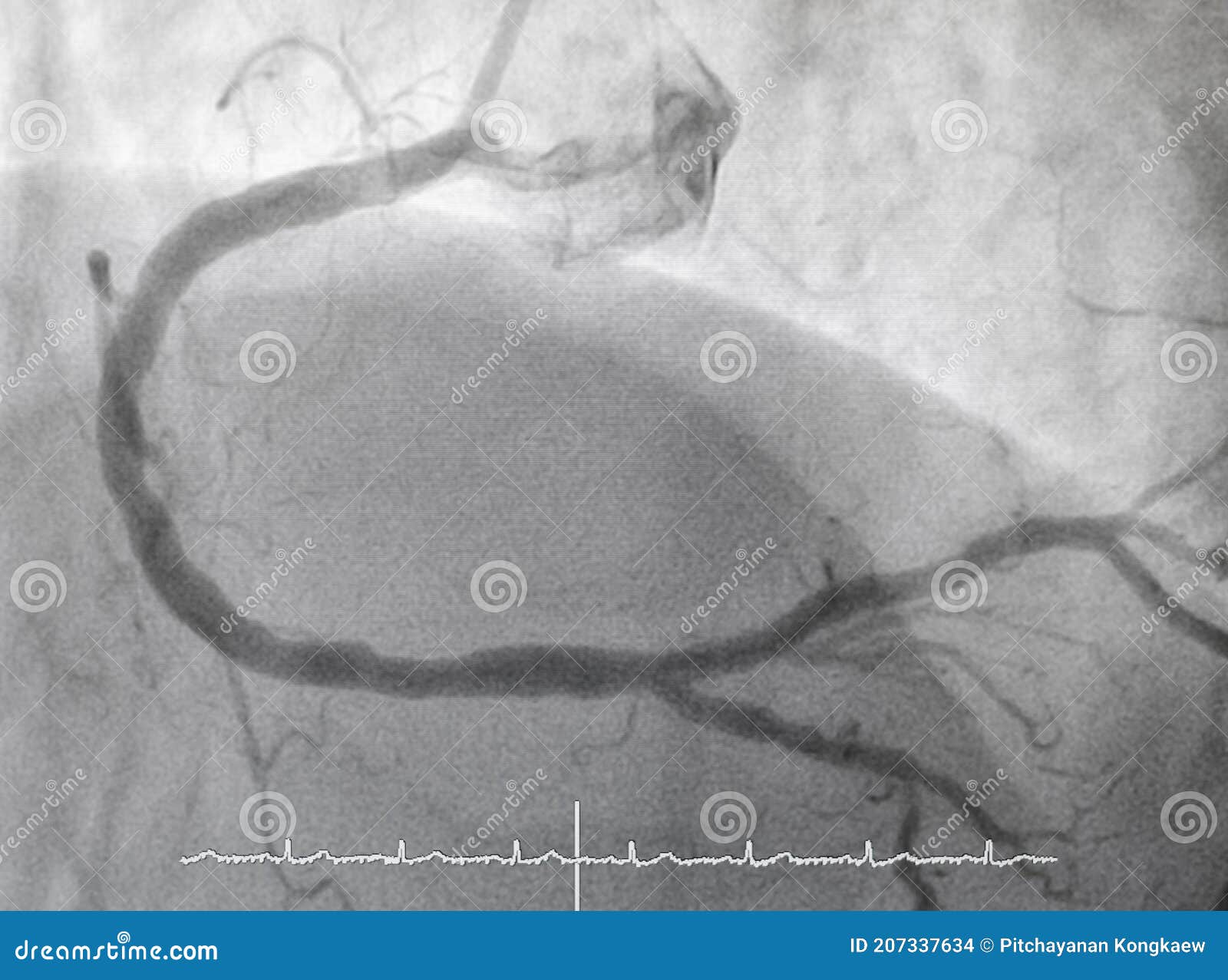 Coronary Angiography. X-ray Image. Vedio Angiogram Stock Photo - Image ...