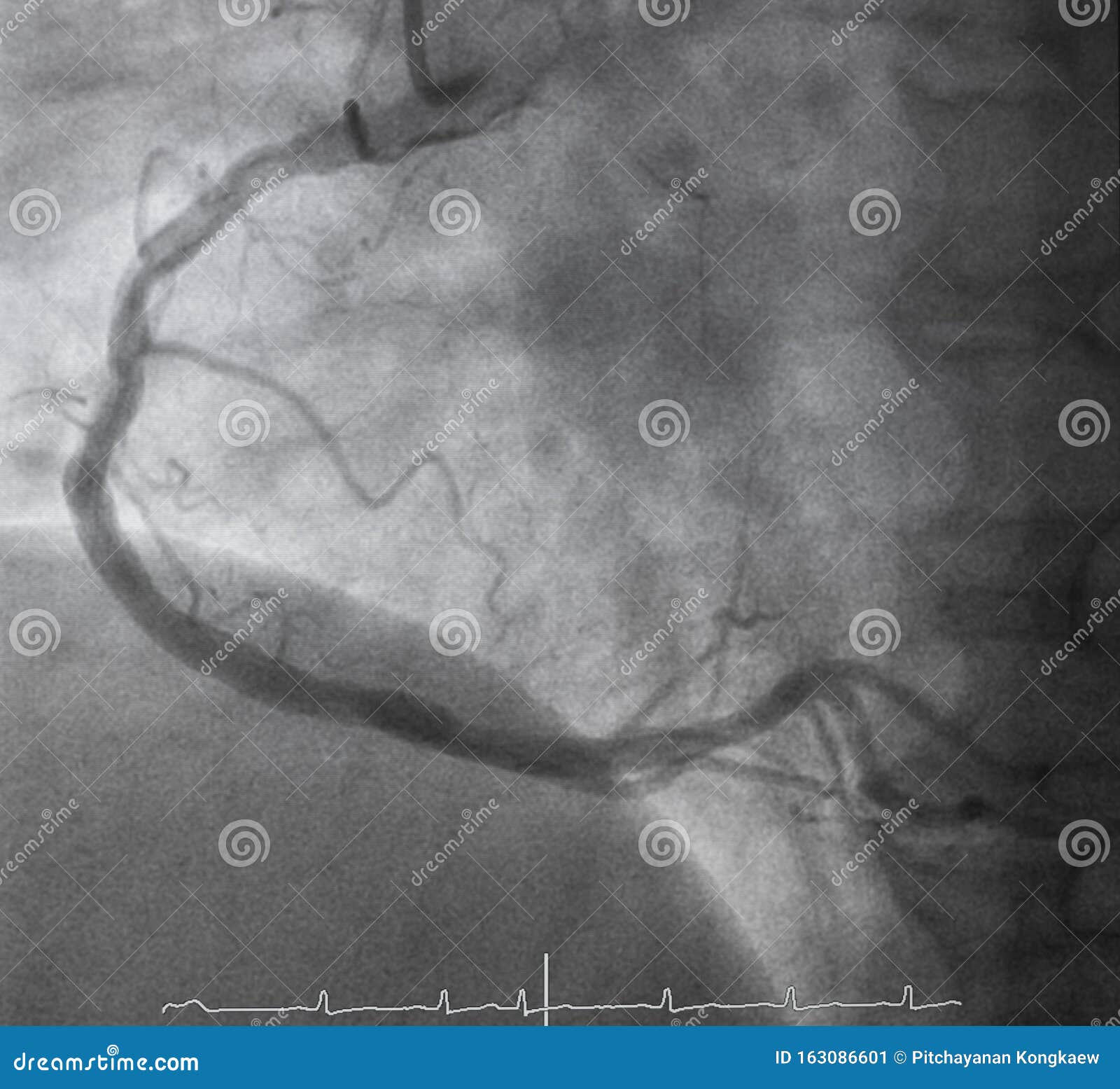 Coronary Angiography , Right Coronary Angiography. Stock Image - Image ...