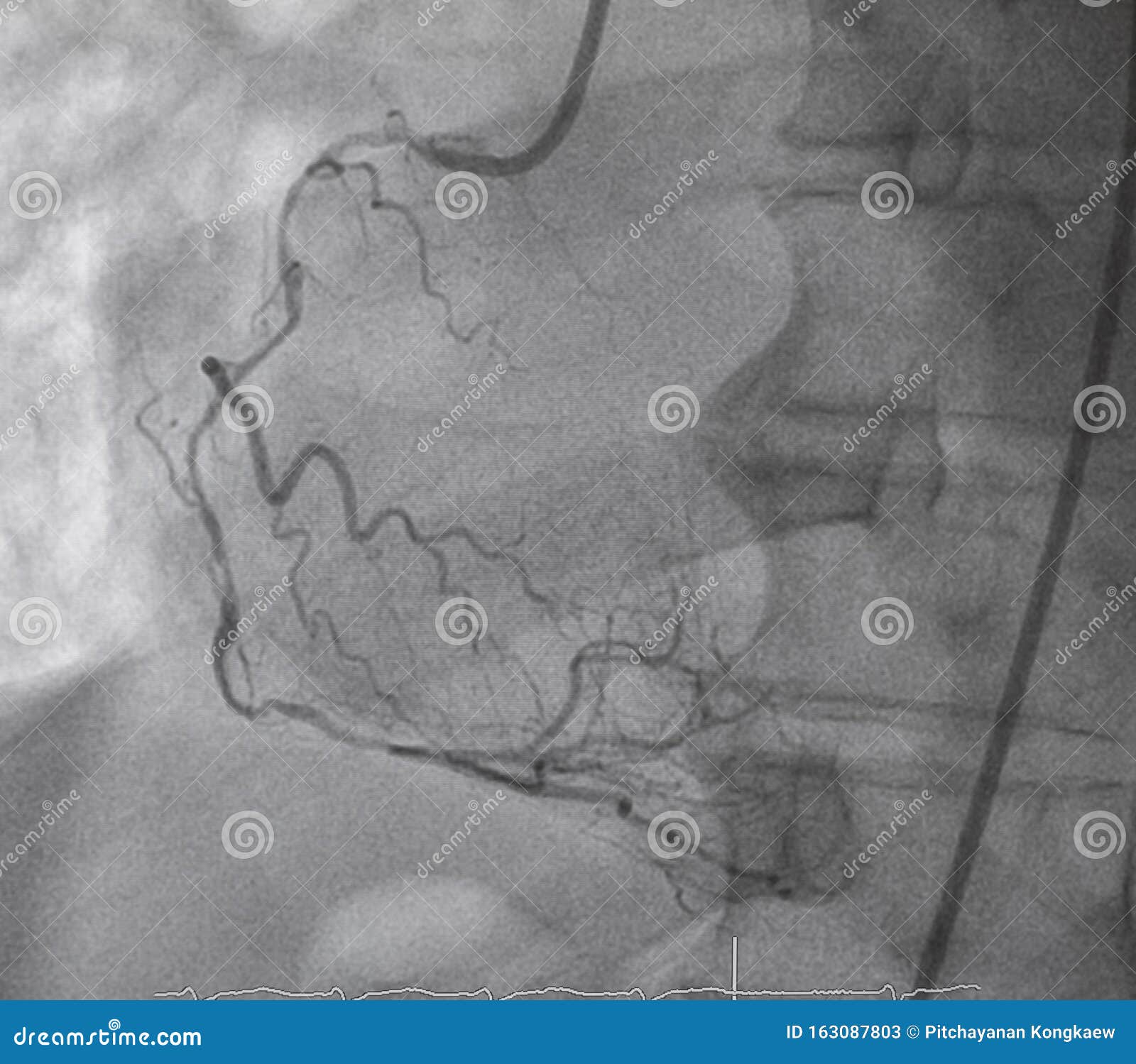 Coronary Angiography.right Coronary Angiography. Stock Image - Image of ...