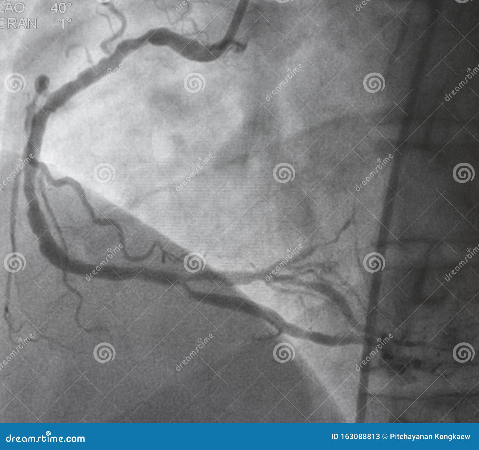 Coronary Angiography.right Coronary Angiography. Stock Image - Image of ...
