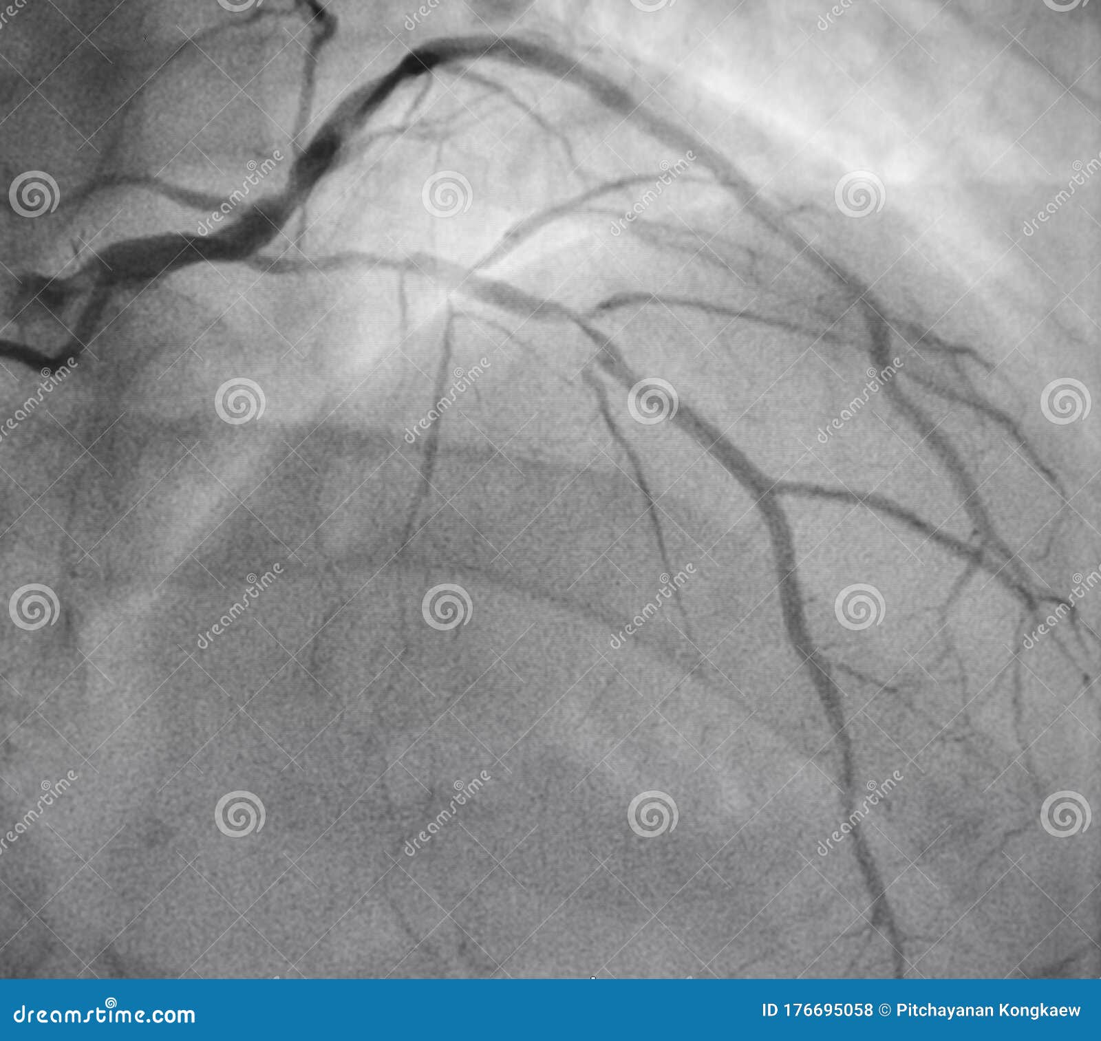Coronary Angiography. X-ray Image. Royalty-Free Stock Photo ...