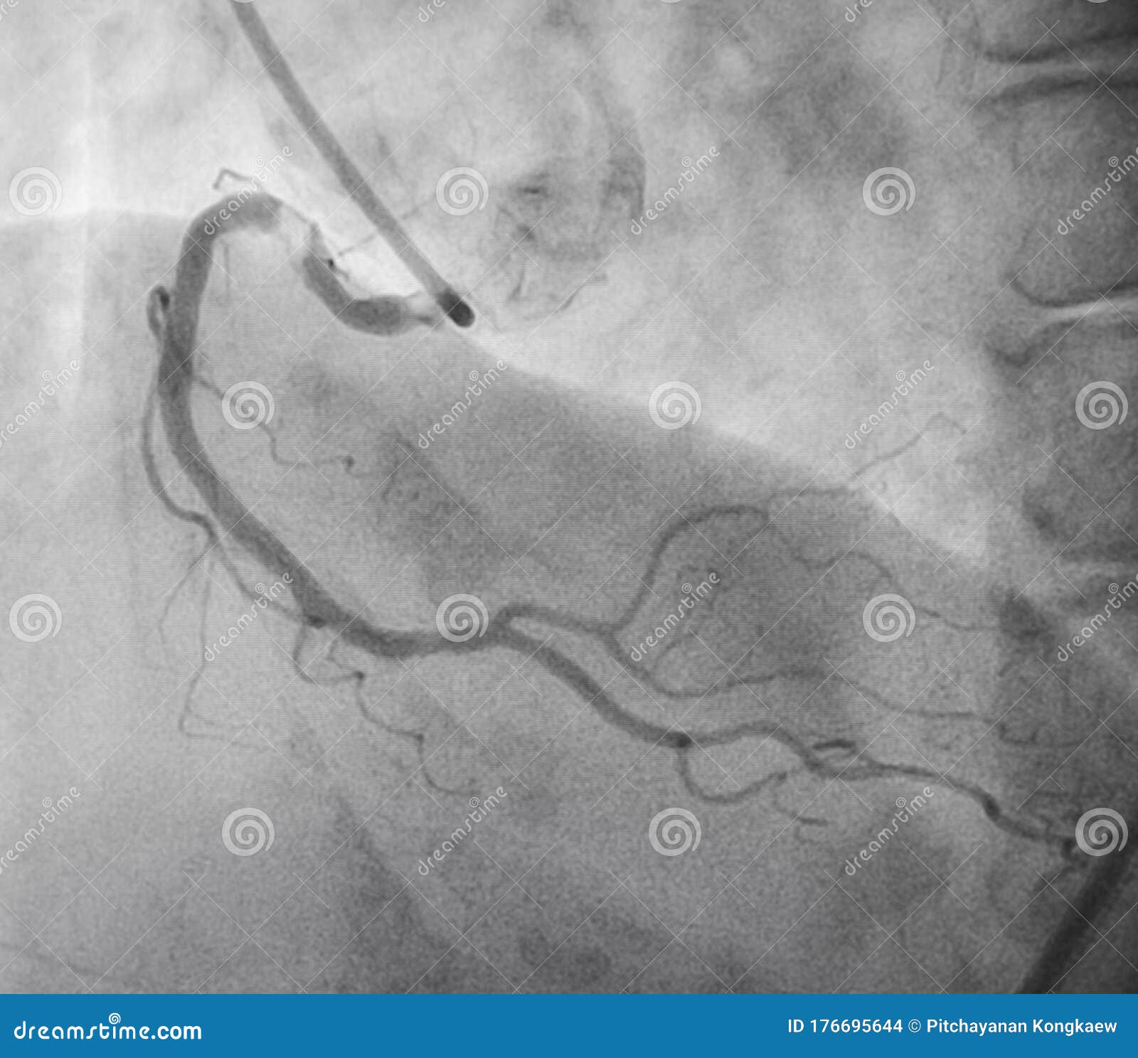 Coronary Angiography. X-ray Image. Stock Photo | CartoonDealer.com ...