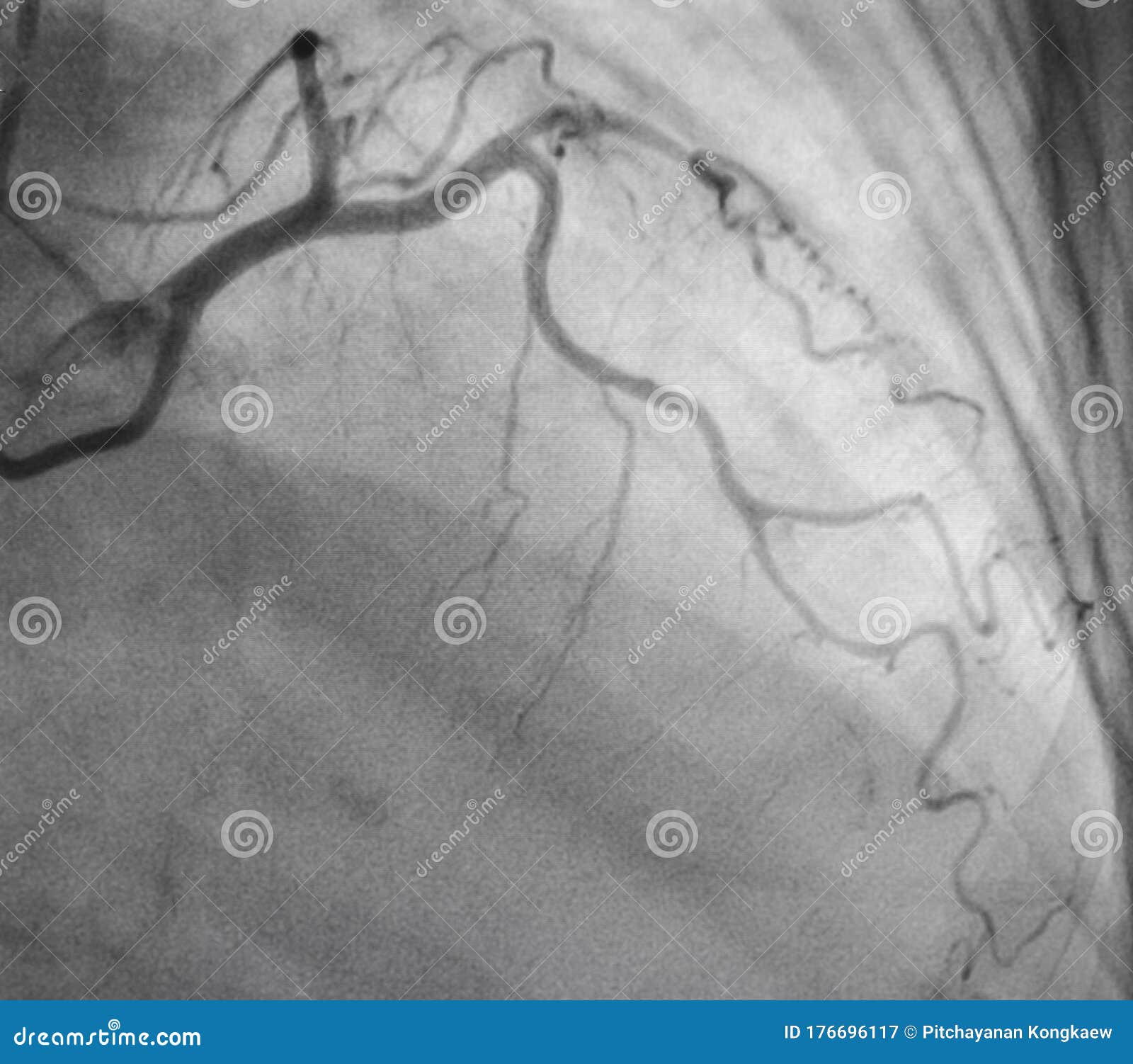 Coronary Angiography. X-ray Image. Royalty-Free Stock Photography ...