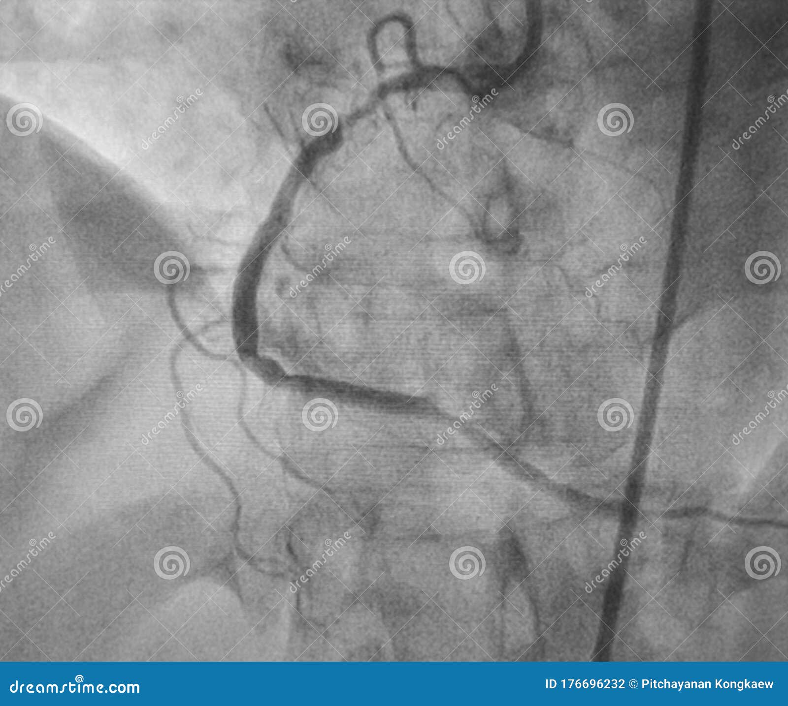 Coronary Angiography. X-ray Image. Stock Photo | CartoonDealer.com ...