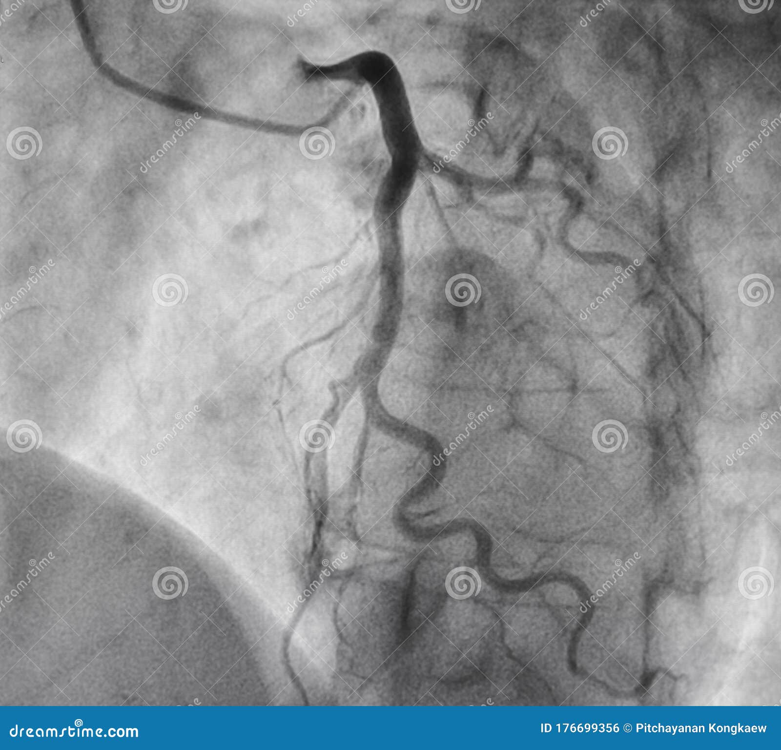 Coronary Angiography. X-ray Image. Stock Photo | CartoonDealer.com ...