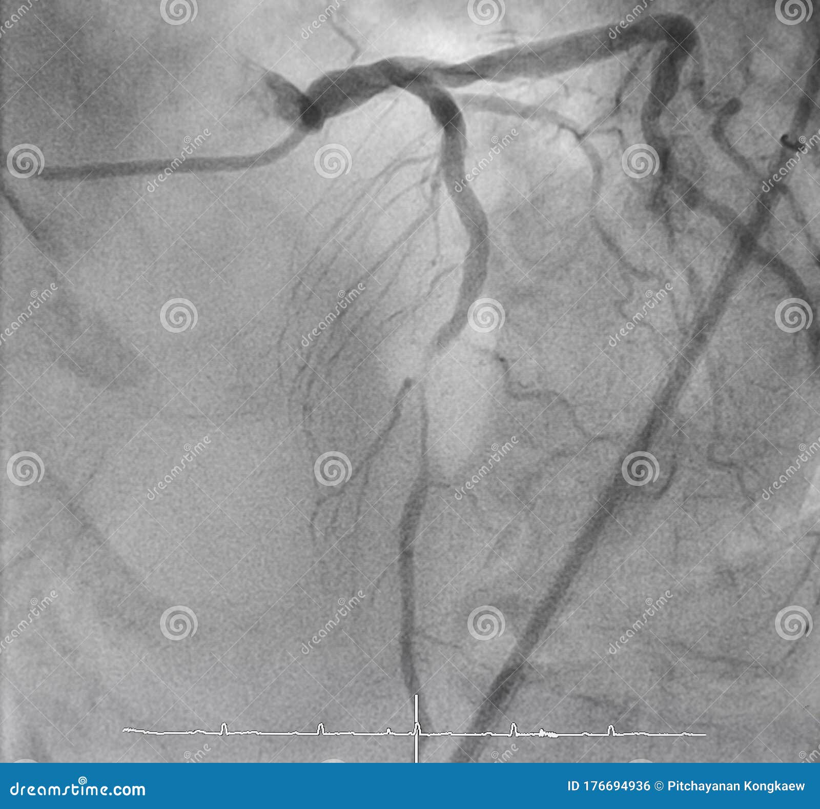 Coronary Angiography. X-ray Image. | CartoonDealer.com #176699356