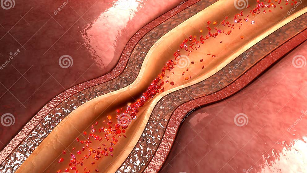 Coronary artery spasm stock illustration. Illustration of anatomy ...