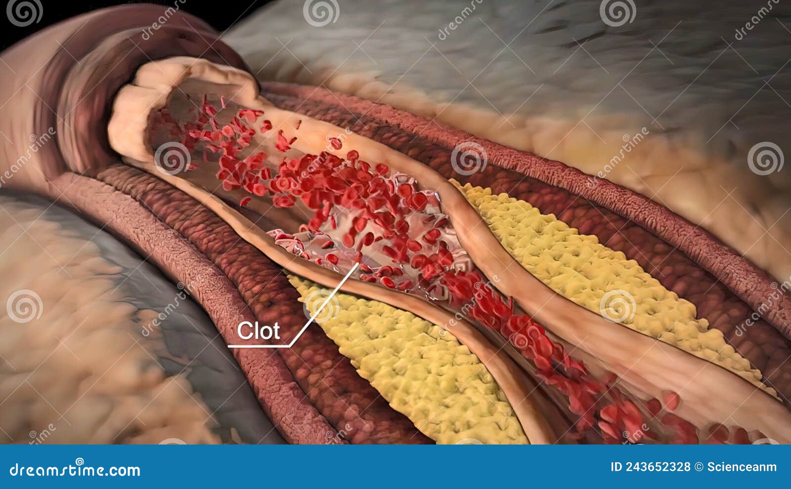Atherosclerosis Process On Different Stages From Healthy Vessel To ...