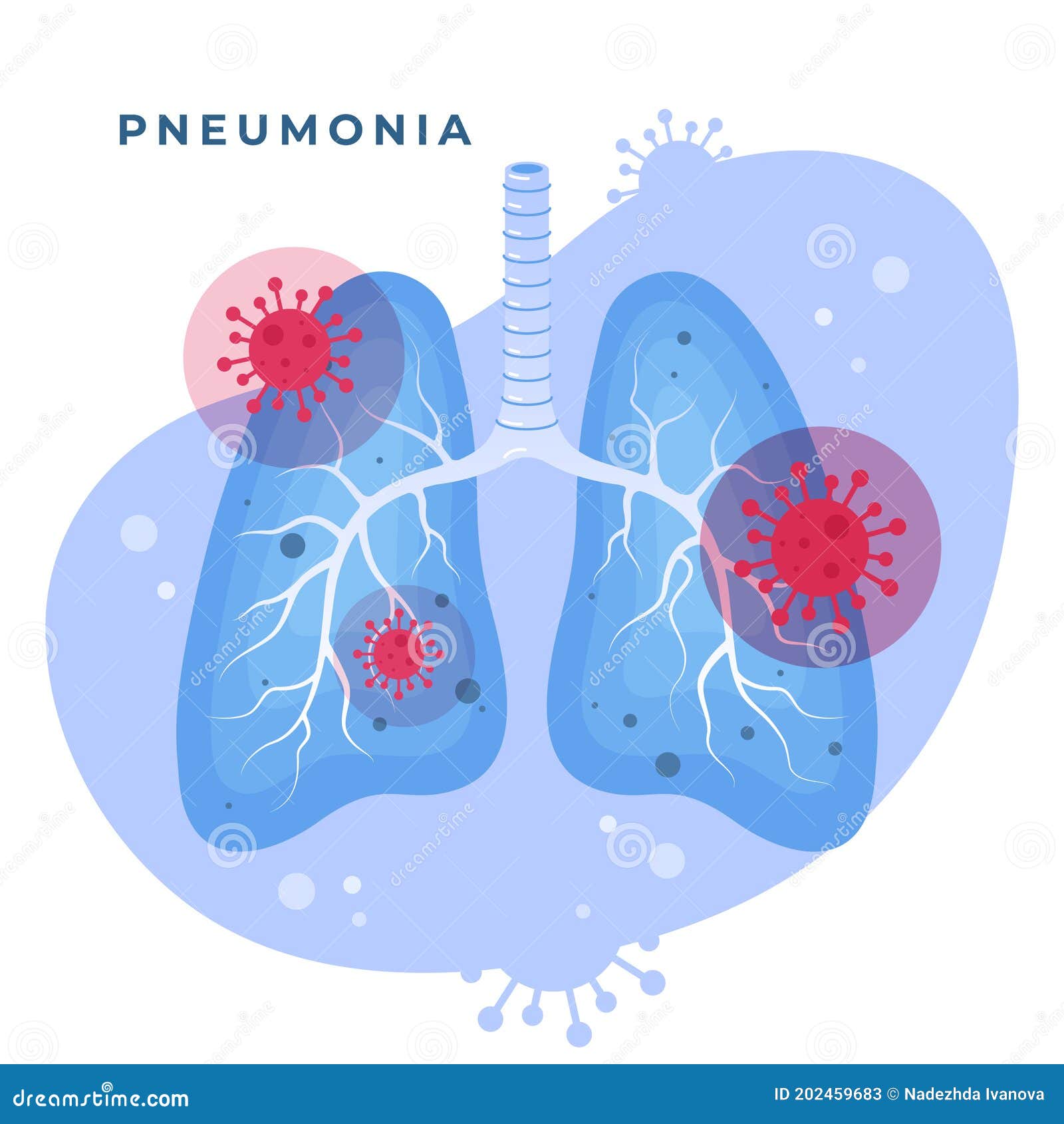 Coronavirus Pneumonia and Illustrated Lungs Vector Illustration Stock ...