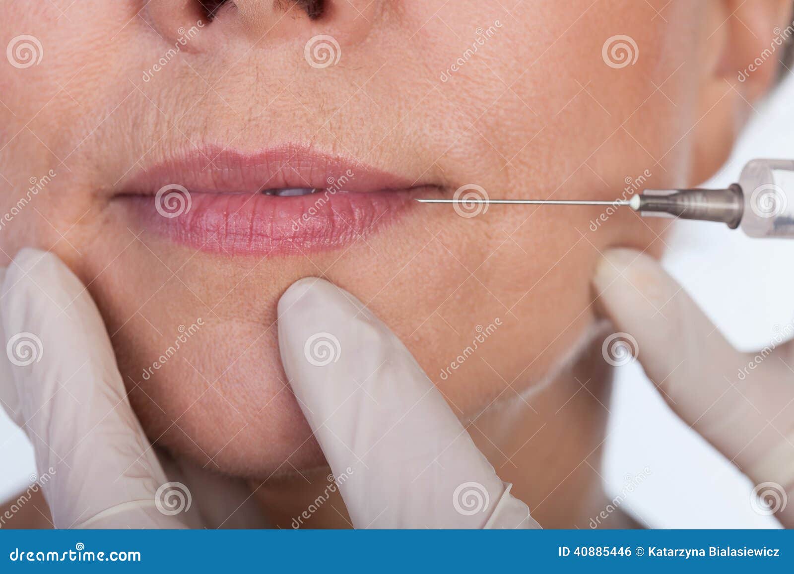 Corrección De Los Labios Usando Botox Foto de archivo - Imagen de ...