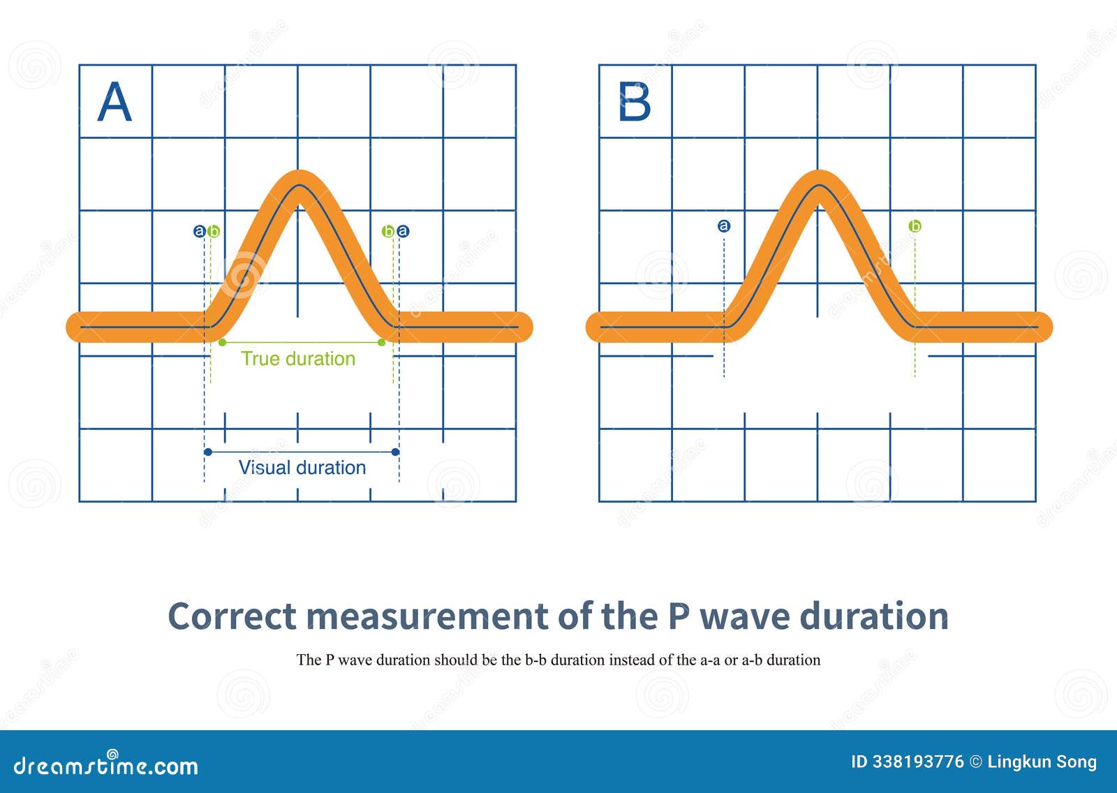 Correct Measurement of the P Wave Duration Stock Illustration ...