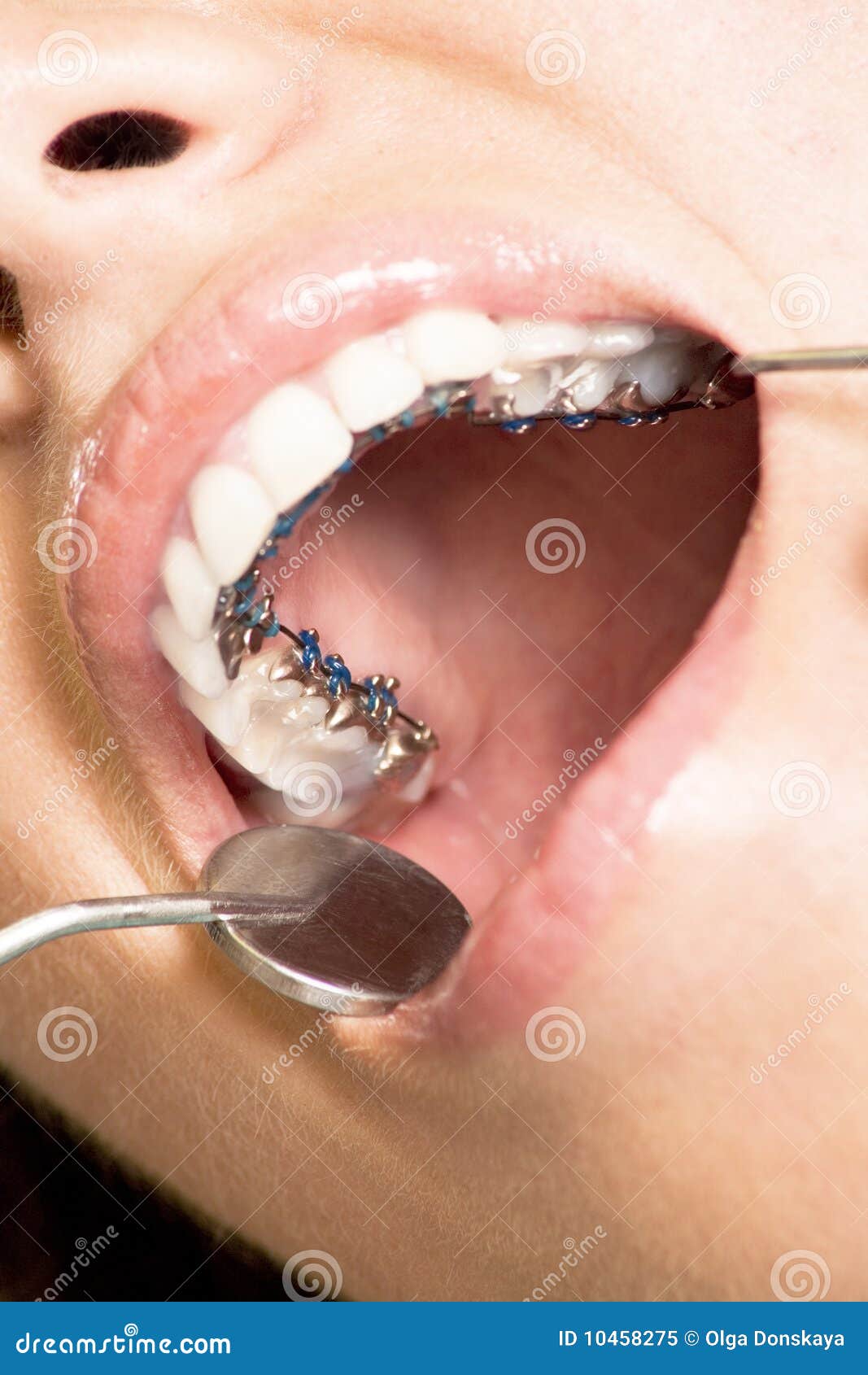 Correcting device on teeth stock image. Image of chin - 10458275
