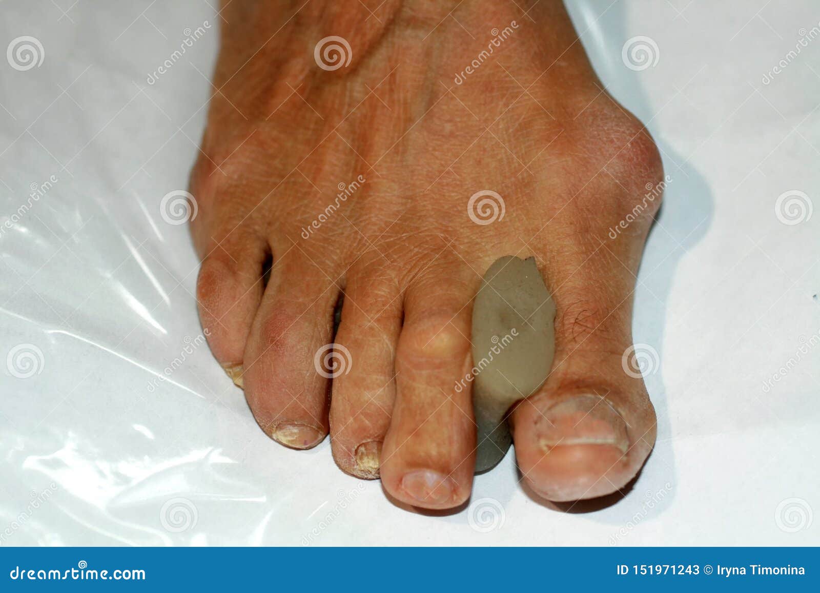 Correction of the Curvature of the Toe Stock Image - Image of illness ...