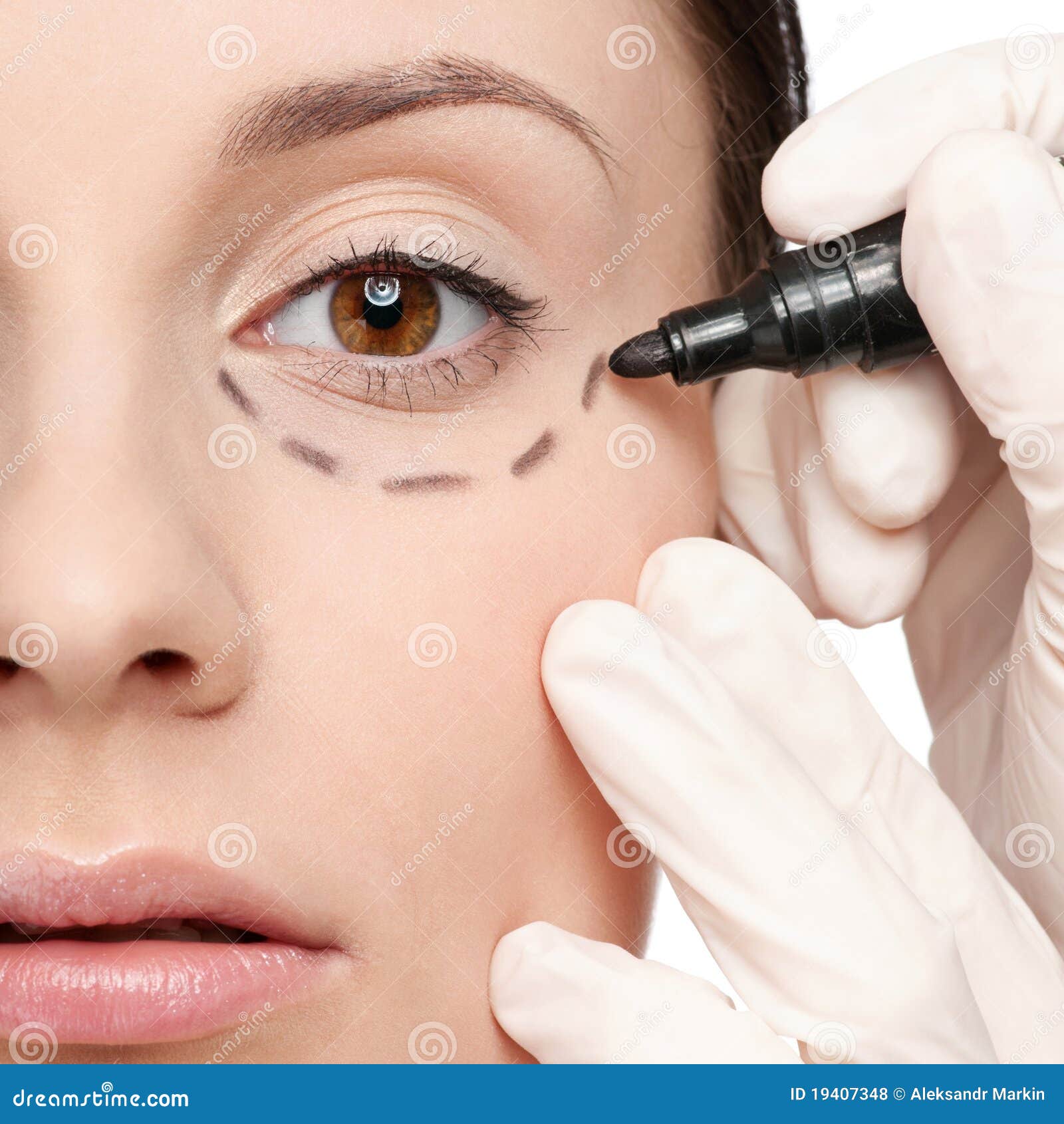 Correction Lines on Woman Face, before Surgery Stock Photo - Image of ...