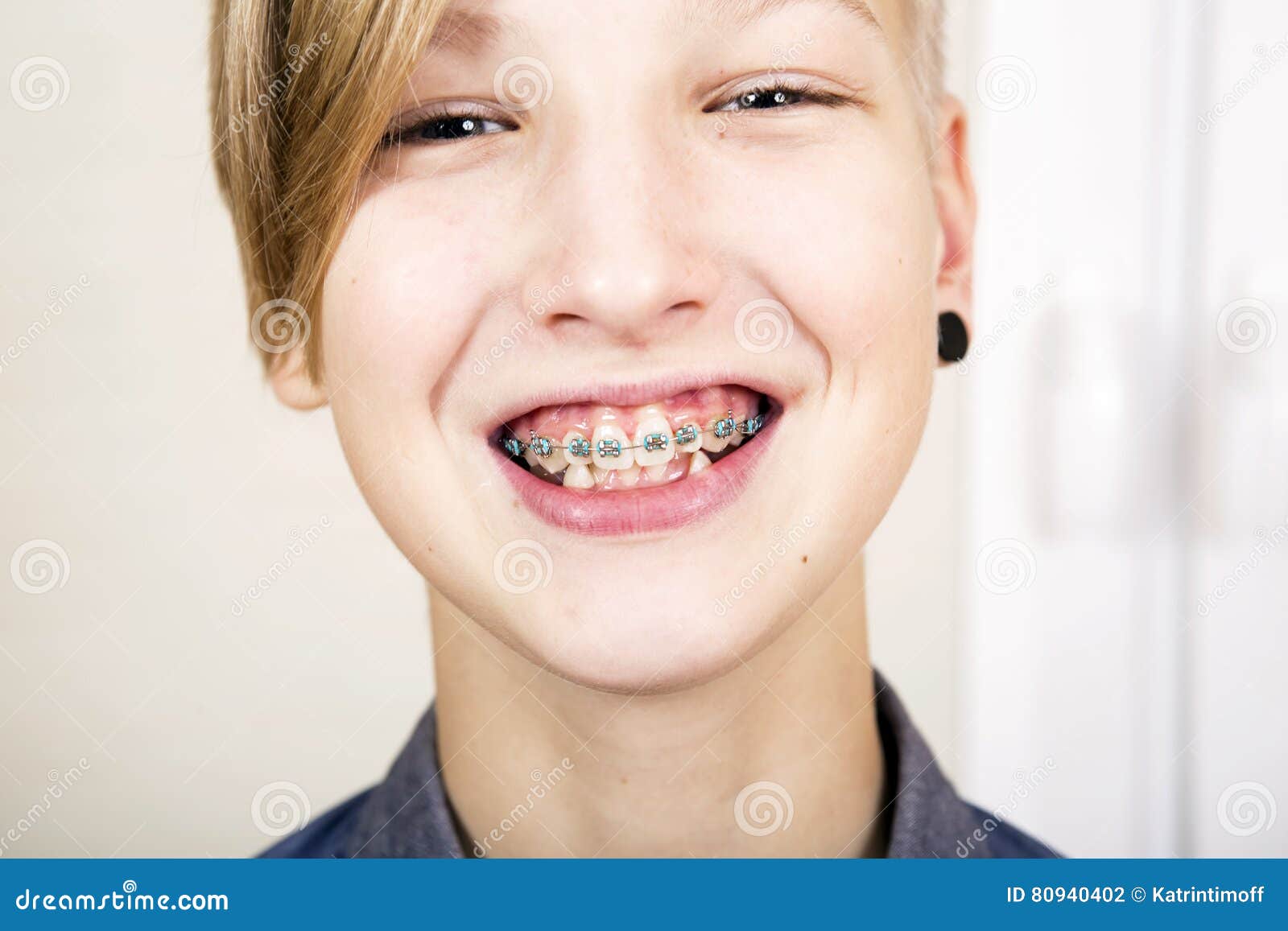 Correzione Del Morso E Di Ortodonzia Fotografia Stock - Immagine di ...