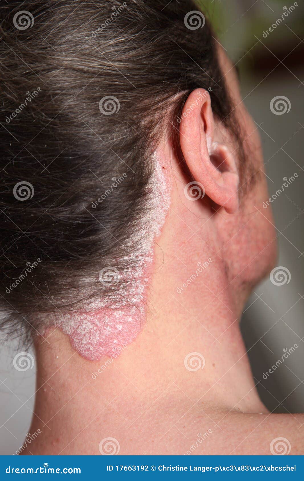 Cou Grave De Psoriasis Et Cou Photo stock - Image du traitement ...