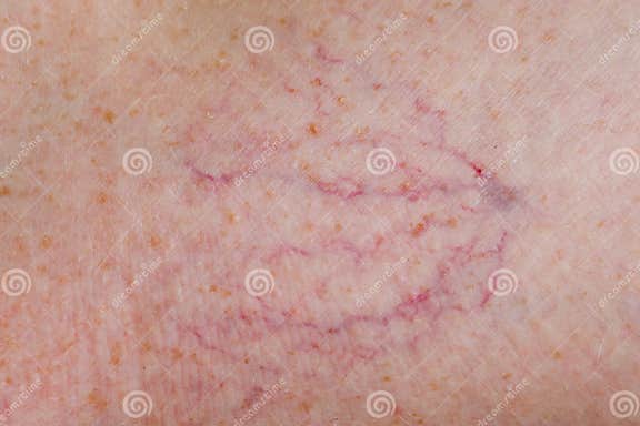 Couperosis stock photo. Image of erythrosis, couperosis - 37521950