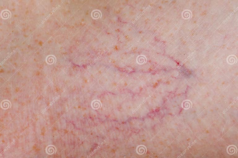 Couperosis stock photo. Image of erythrosis, couperosis - 37521950