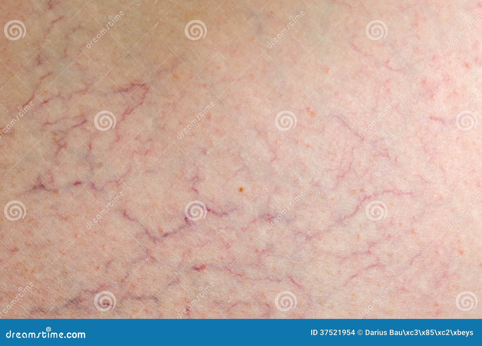 Couperosis stock photo. Image of blemishes, dermatology - 37521954