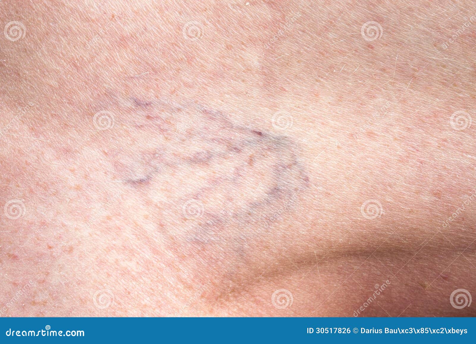 Couperosis stock photo. Image of papules, vessels, skin - 30517826