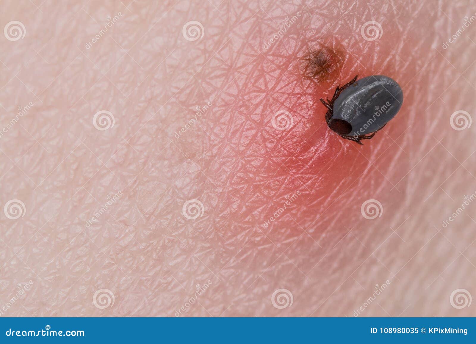 Coutil Et Tache De Rousseur Ricinus D'Ixodes Image stock - Image du ...