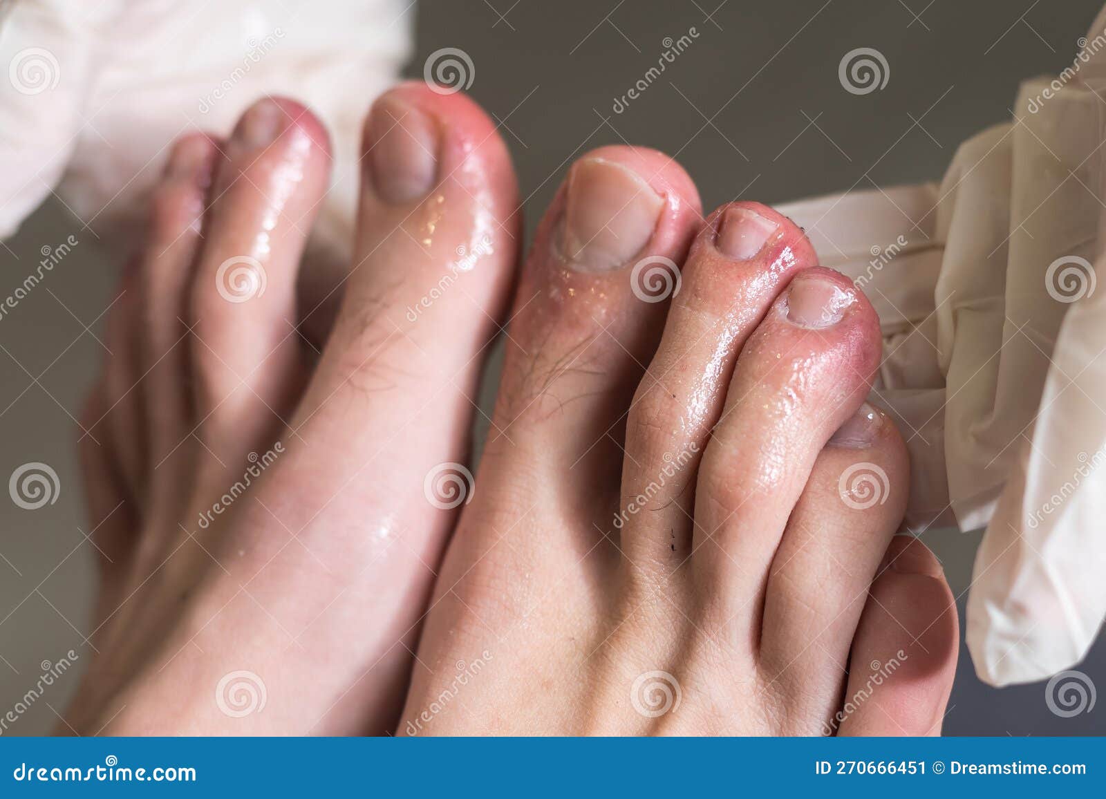 Covid Toes, Bites on a Man S Toes. Stock Image - Image of bite ...