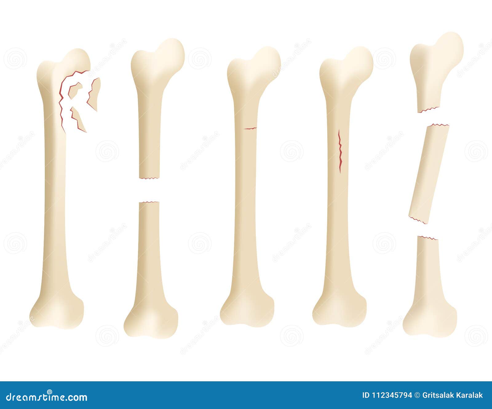 Crack Human Bone Vector Illustration | CartoonDealer.com #112345794