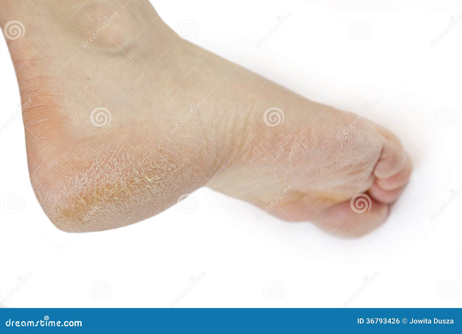 Cracked foot stock photo. Image of illness, unhealthy - 36793426