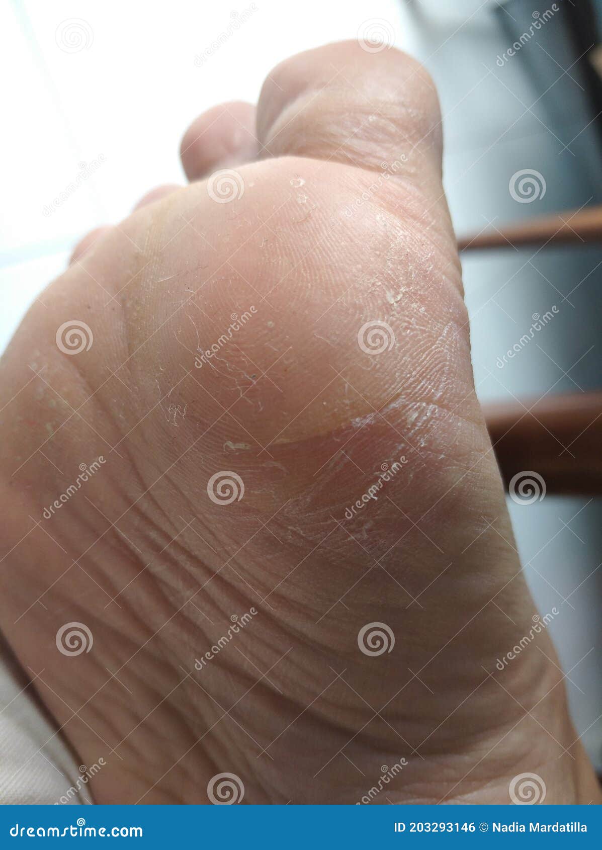 Cracked Heel On Isoleted Background. Royalty-Free Stock Image ...