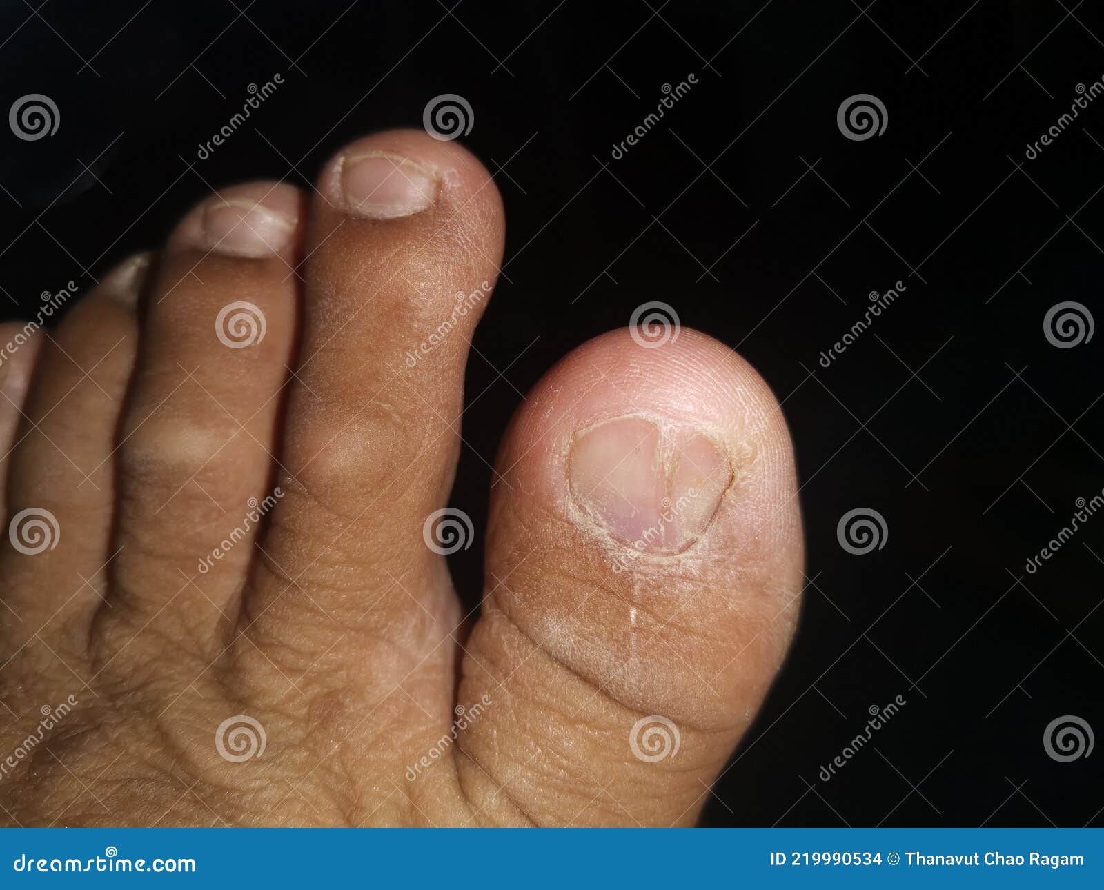 Cracks on toenails stock photo. Image of tattoo, nail - 219990534