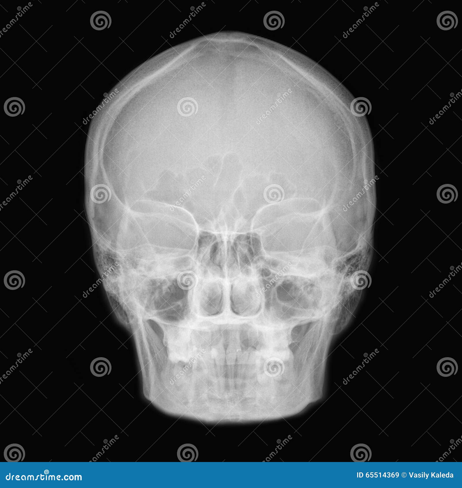 Cranium stock image. Image of socket, black, roentgenogram - 65514369