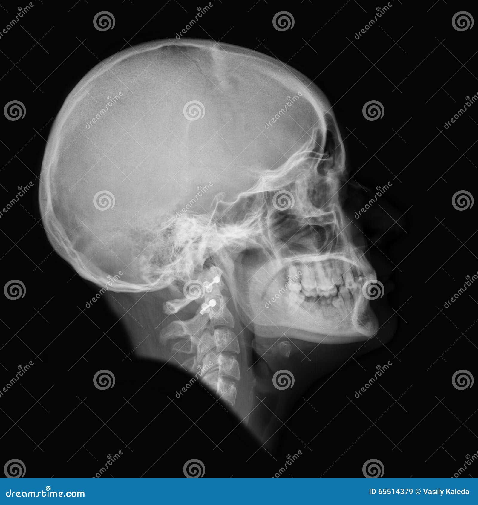 Cranium stock image. Image of diagnostic, roentgen, black - 65514379