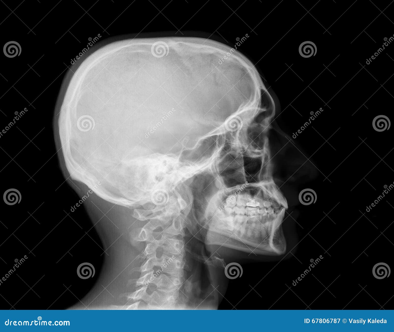 Cranium stock image. Image of frontal, profile, human - 67806787