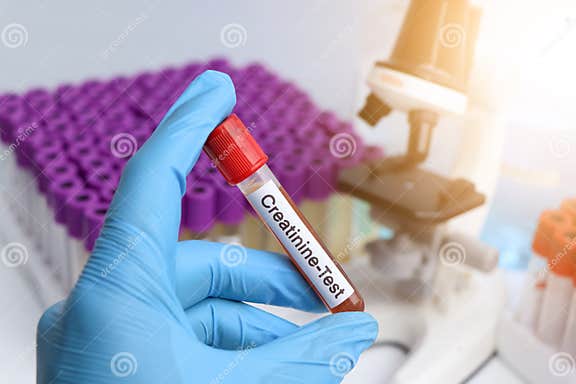 Creatinine Test from Blood , Blood Samples To Be Analyzed Stock Image ...