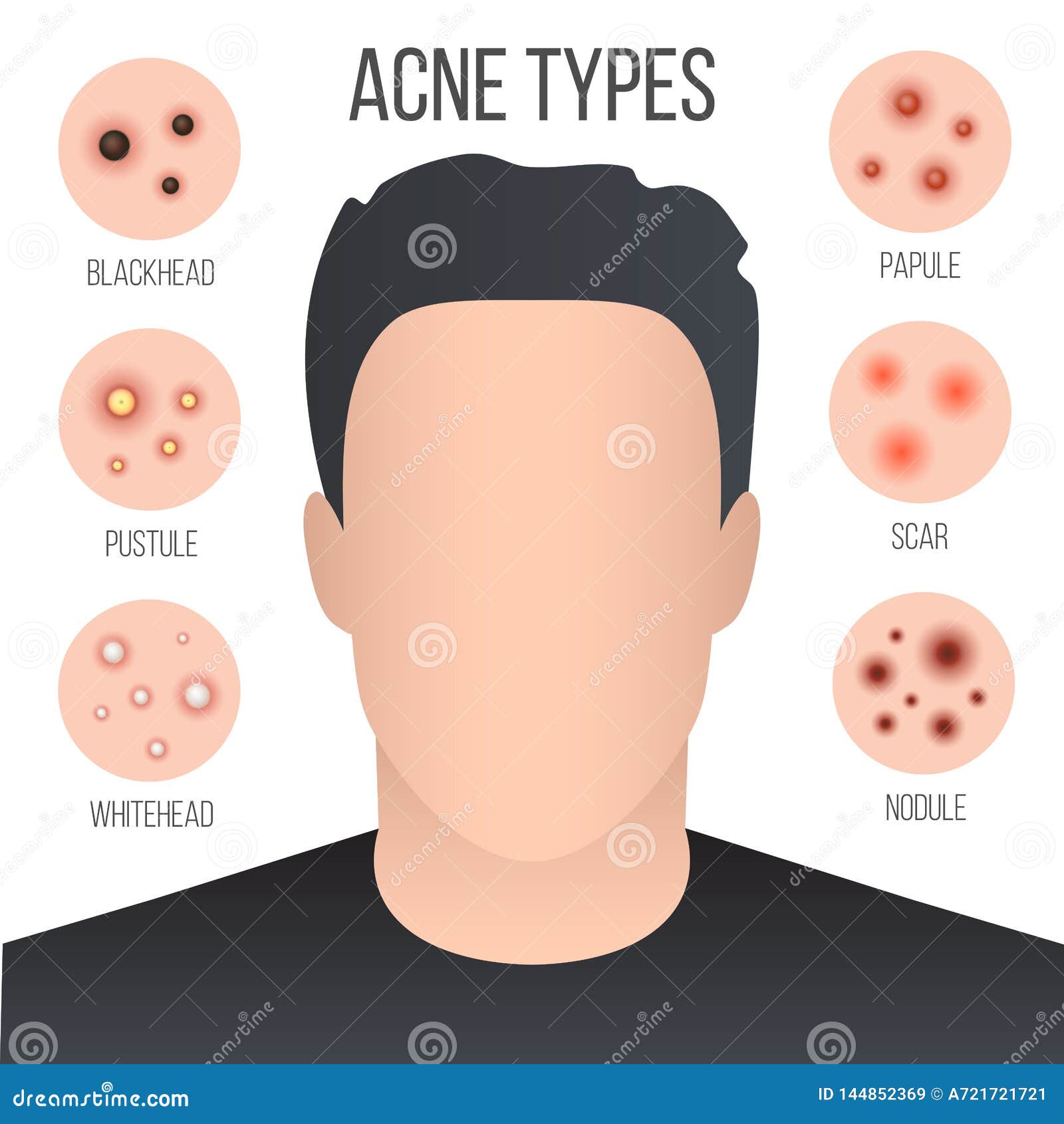 Creative Illustration Types Of Acne Pimples Skin Pores Blackhead