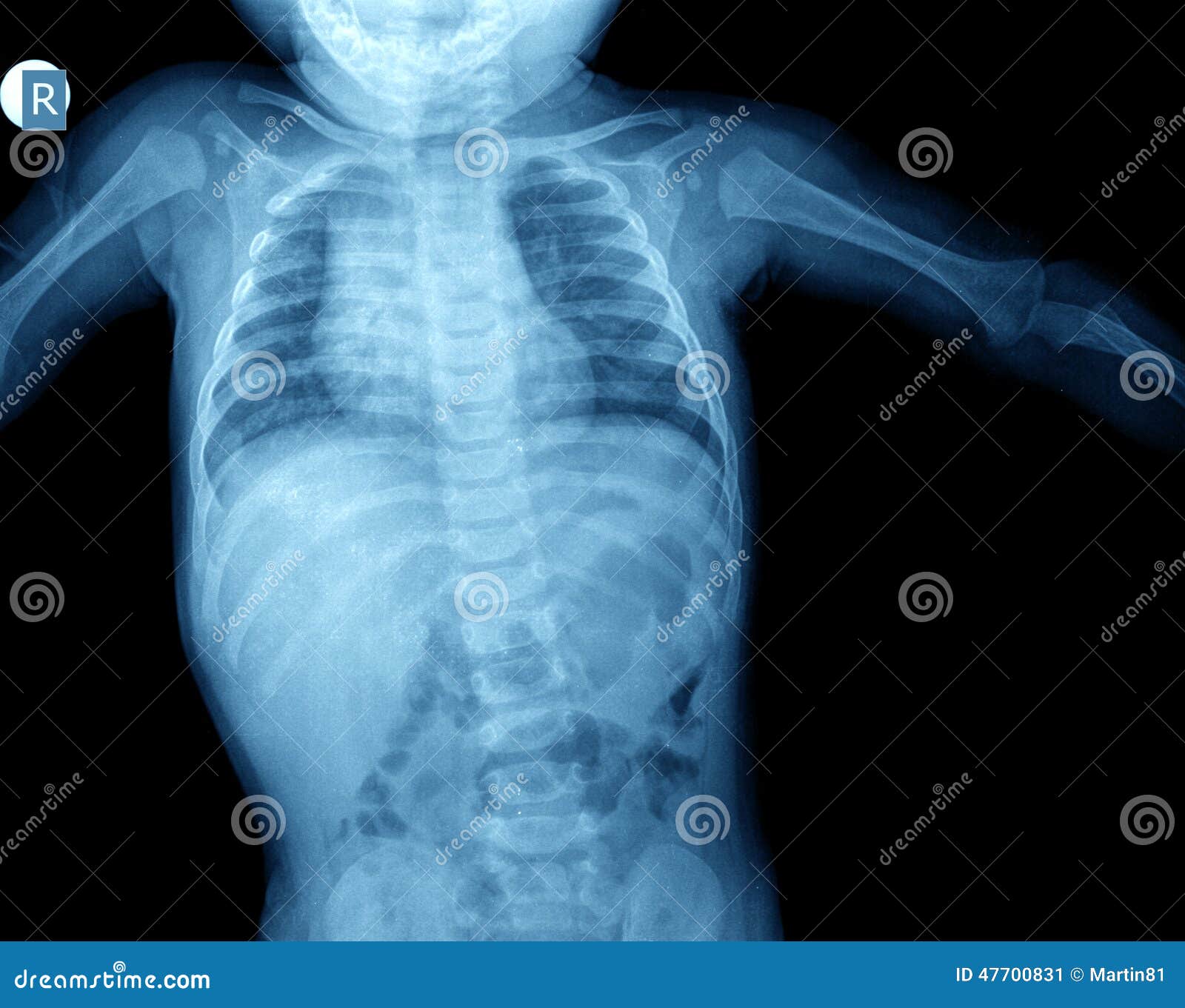 Criança Da Caixa Da Imagem Do Raio X Imagem de Stock - Imagem de ...