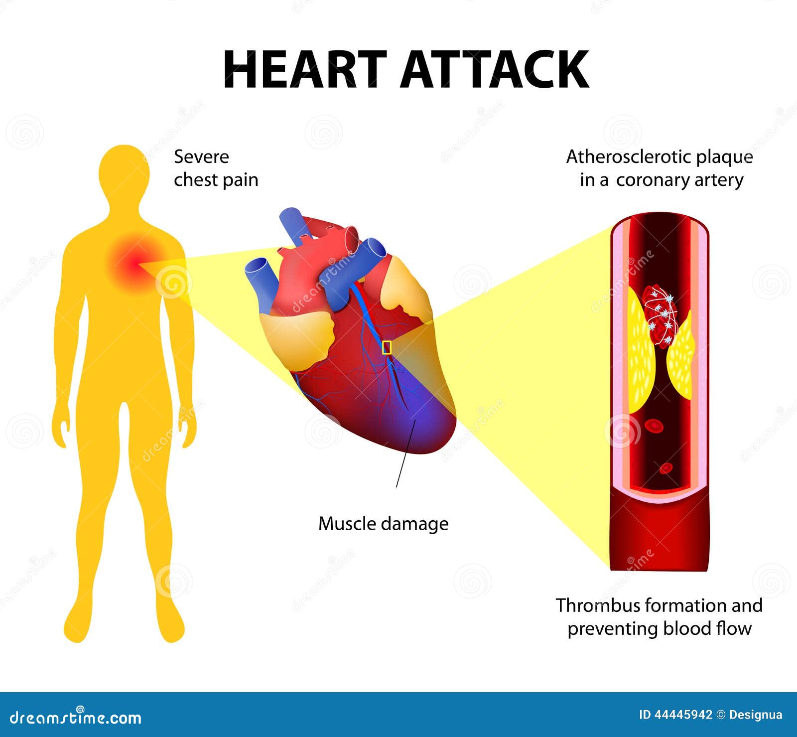 Crise cardiaque illustration de vecteur. Illustration du flux - 44445942