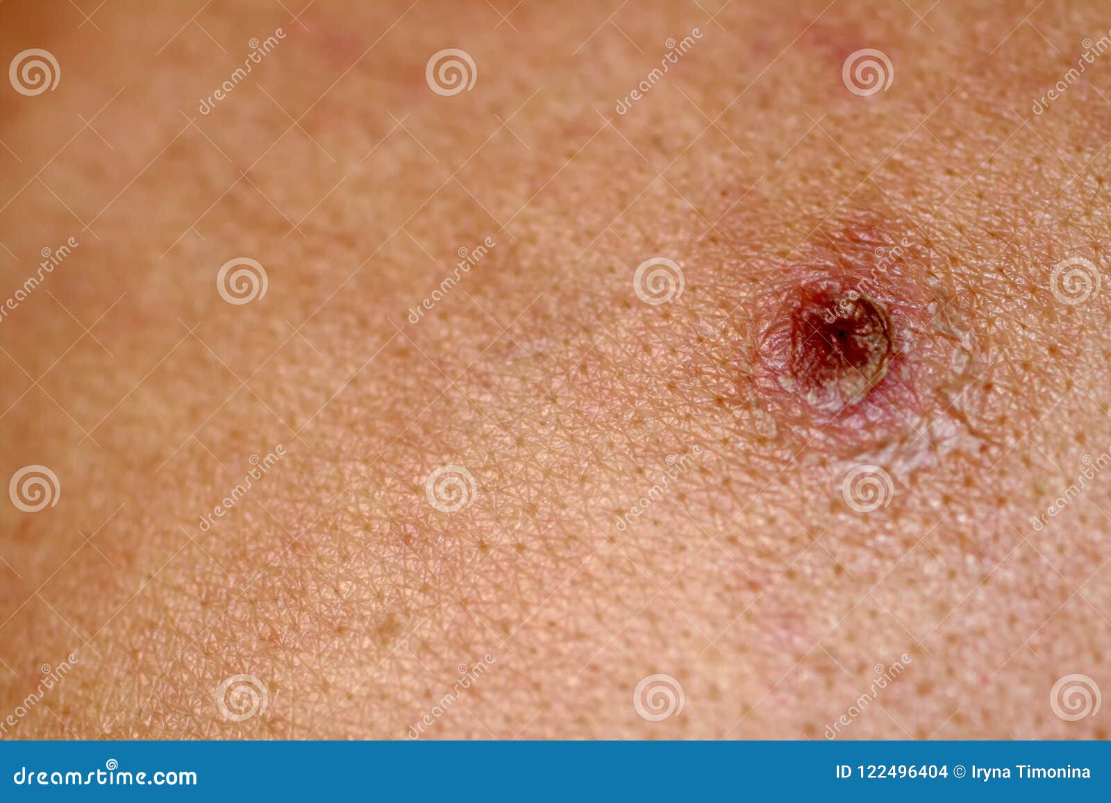 2,945 Blessure Sur La Peau Photos libres de droits et gratuites de ...