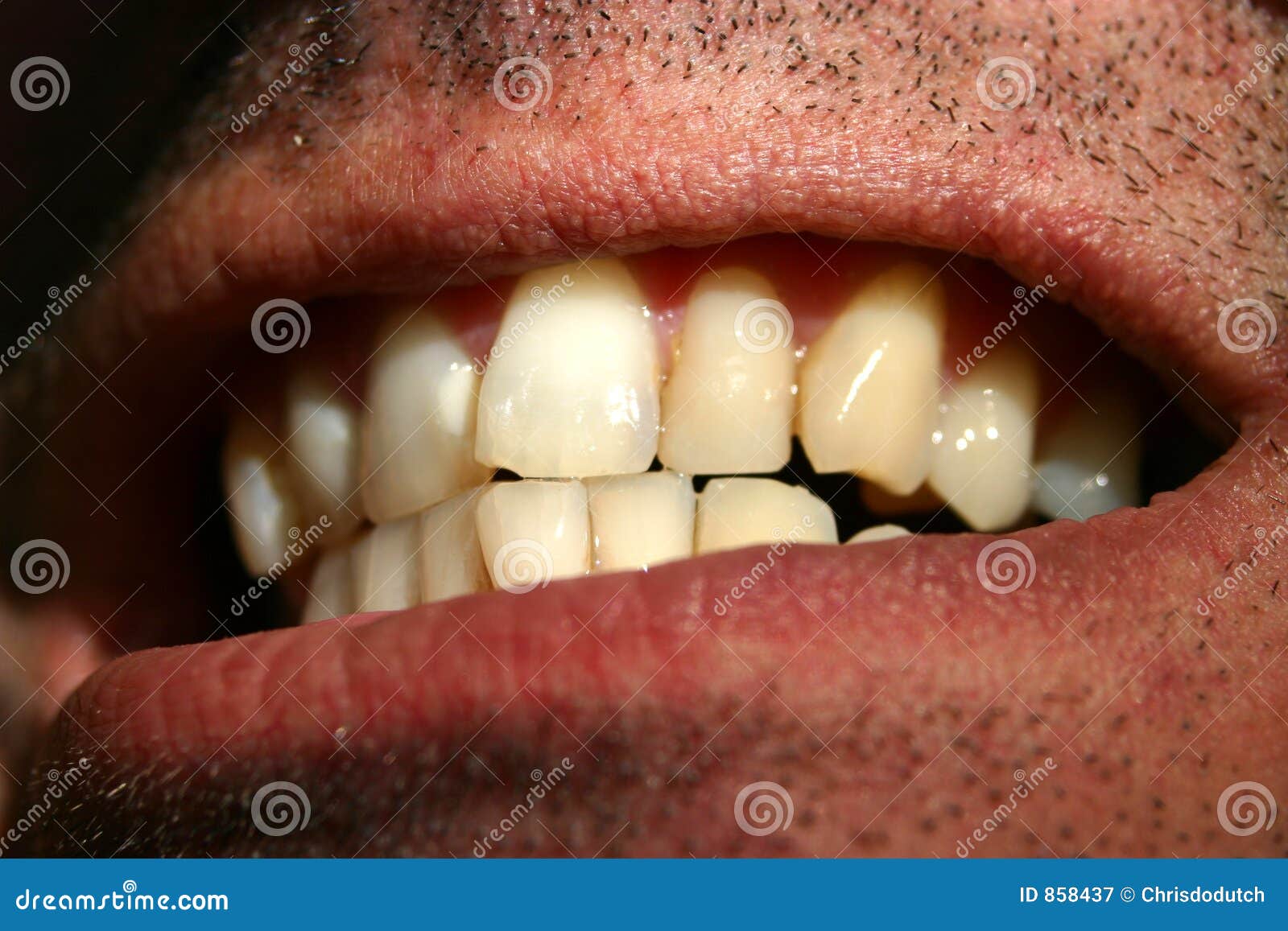 Yellow Crooked Teeth