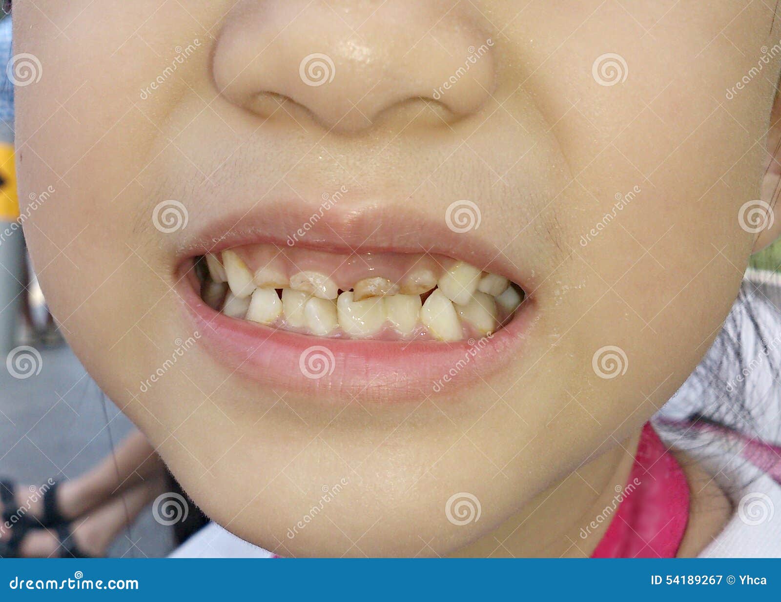 Crooked teeth stock image. Image of dirty, broken, teeth - 54189267