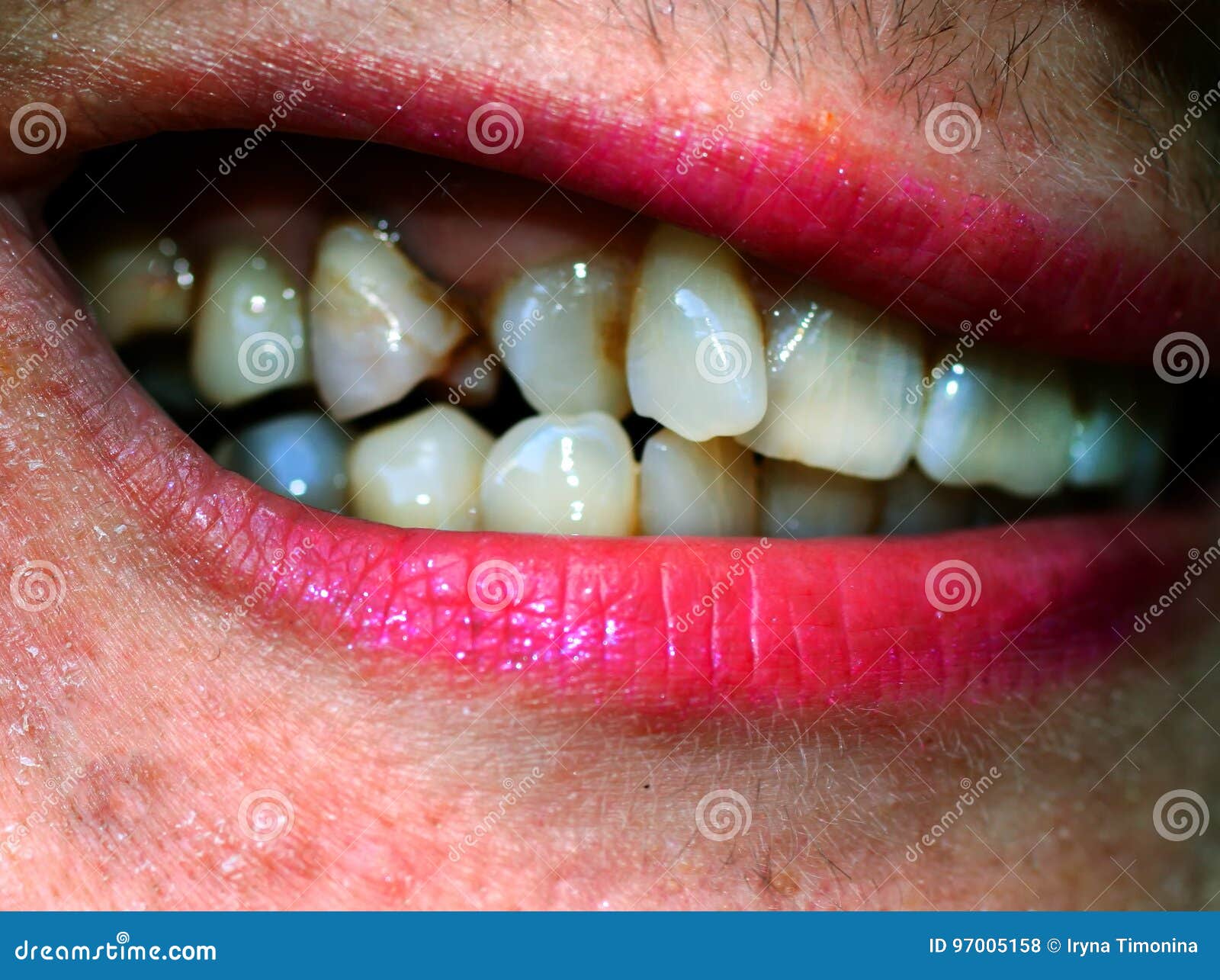 Crooked Teeth in the Mouth. Orthodontics. Malocclusion. Stock Photo ...